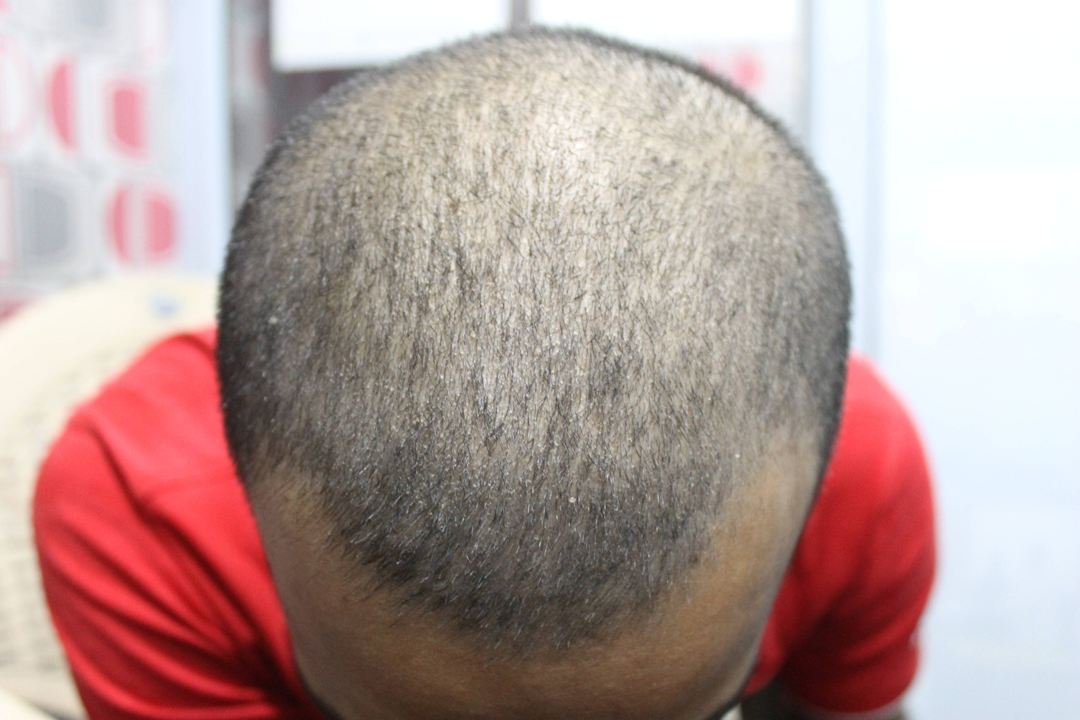 Remarkable Recovery in case of Seborrhoeic Dermatitis with homeopathy ...