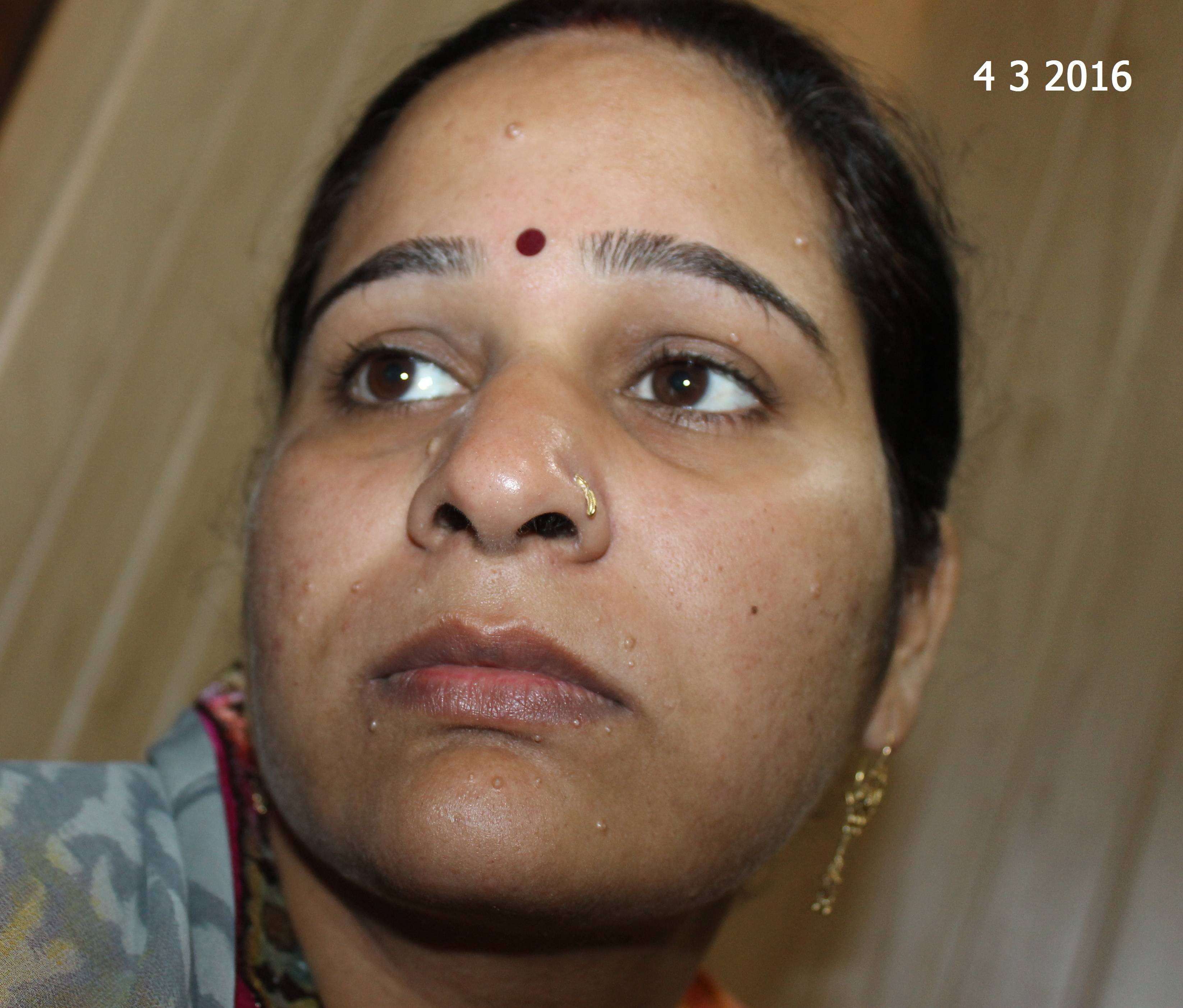 Speedy Recovery in case of Molluscum Contagiosum with Homeopathy | Case Study