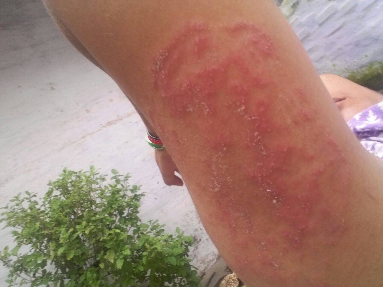 Complete recovery in case of tinea corporis (ringworm) with homeopathy ...