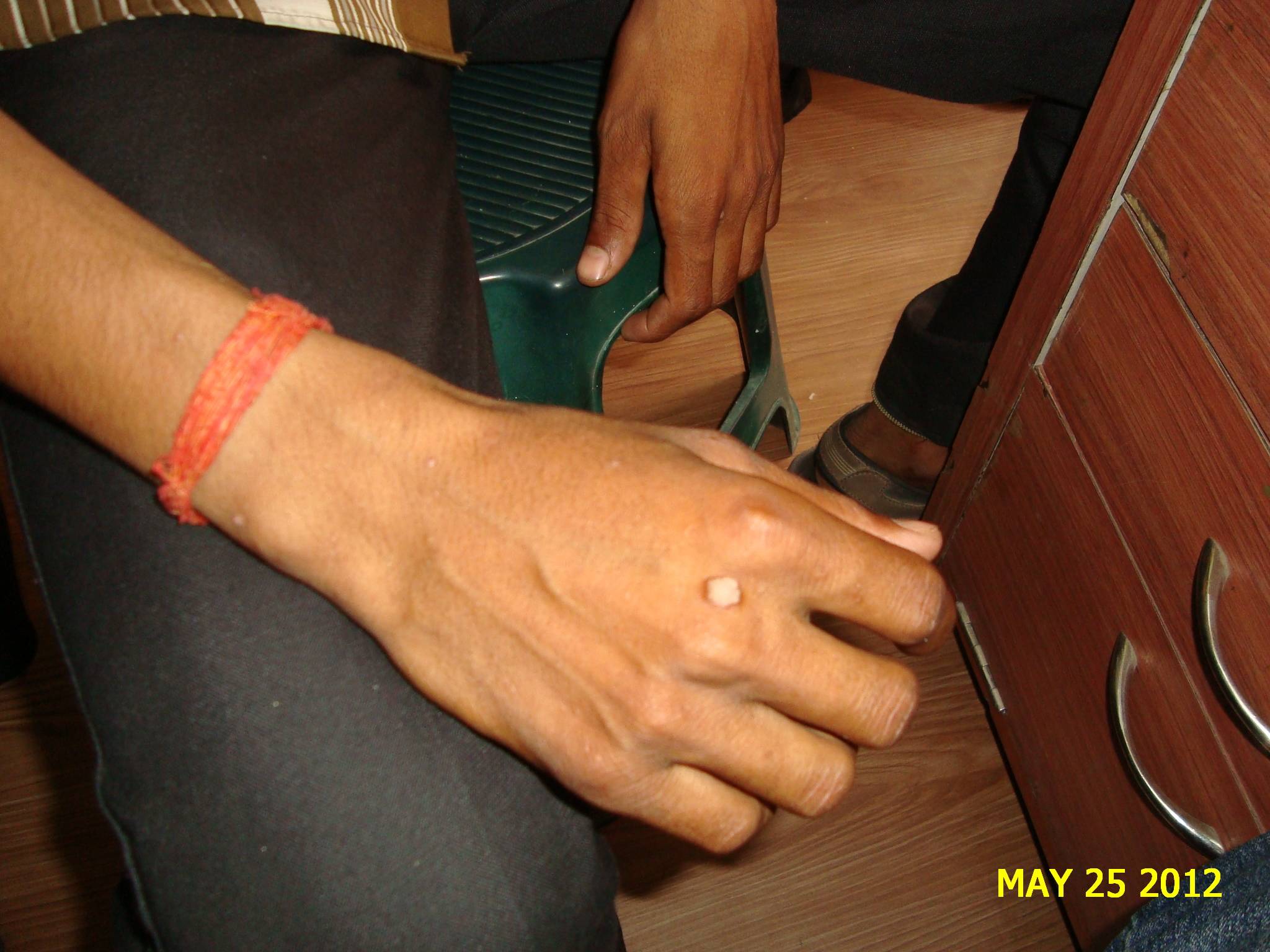 Years Long Wart cured in 3 weeks with homeopathy | Case Study