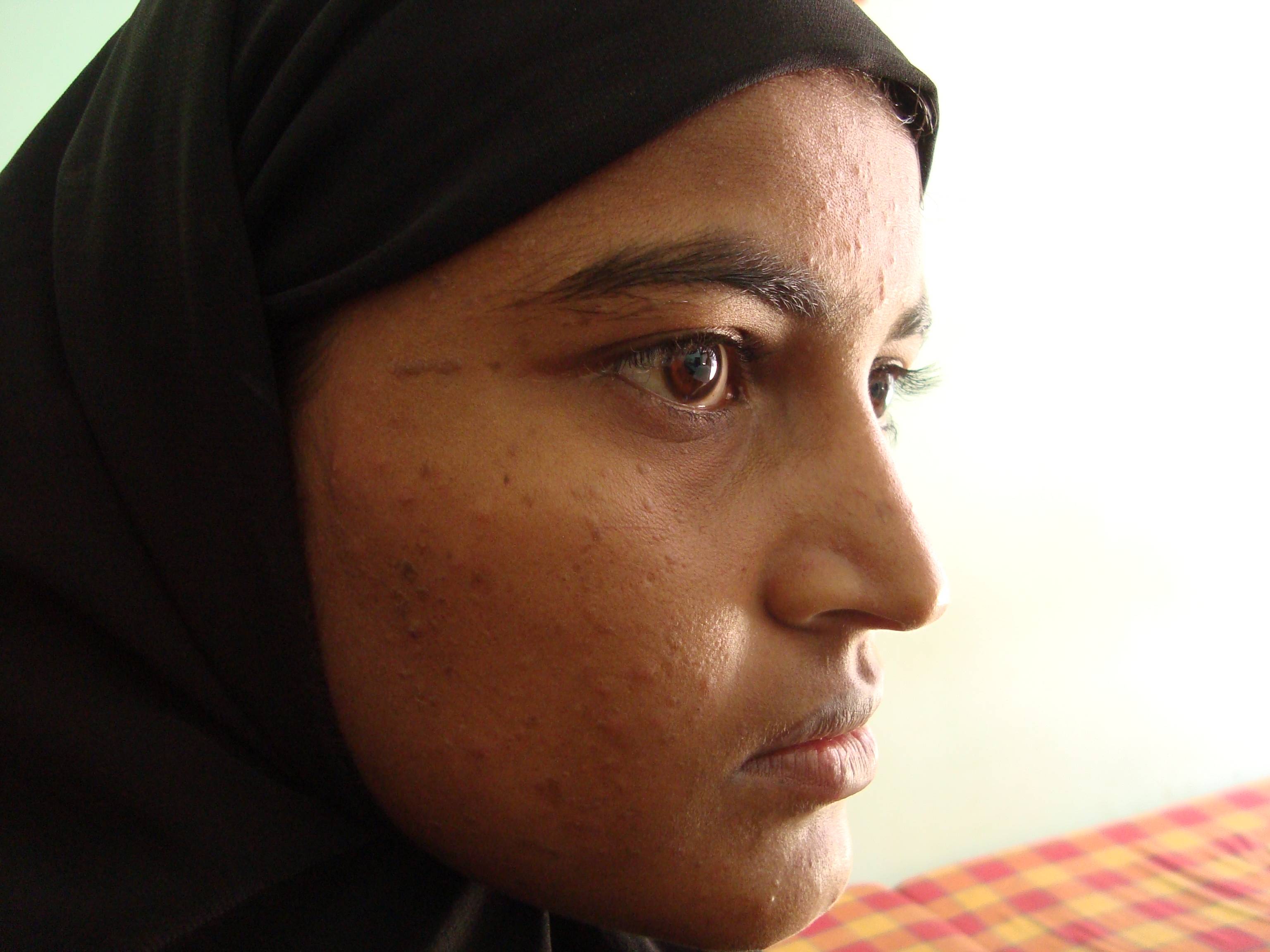 Chronic Hyper hydrosis (Sweat Problem) from last 2 - 3 years & Wart ...