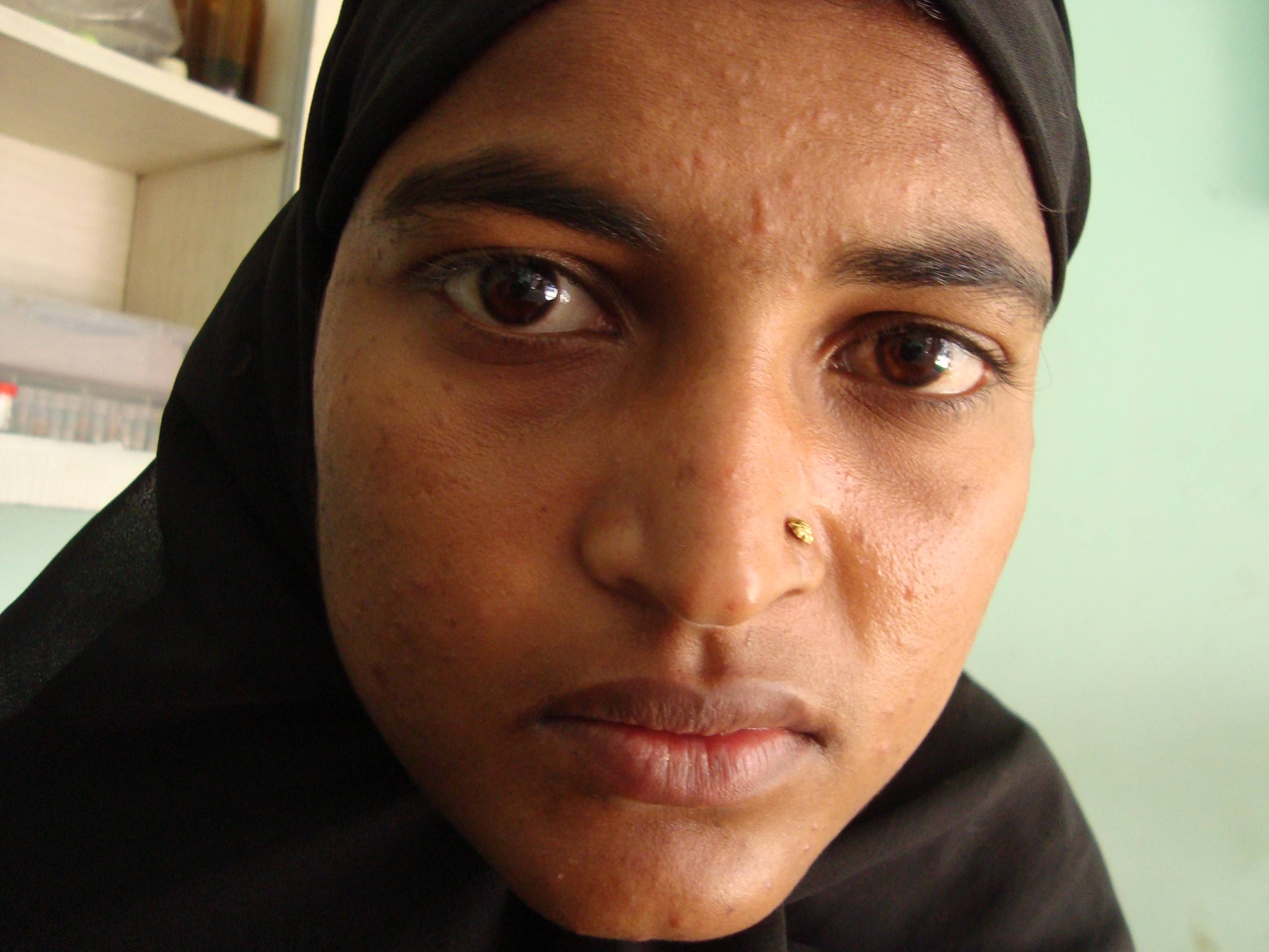 Chronic Hyper hydrosis (Sweat Problem) from last 2 - 3 years & Wart ...