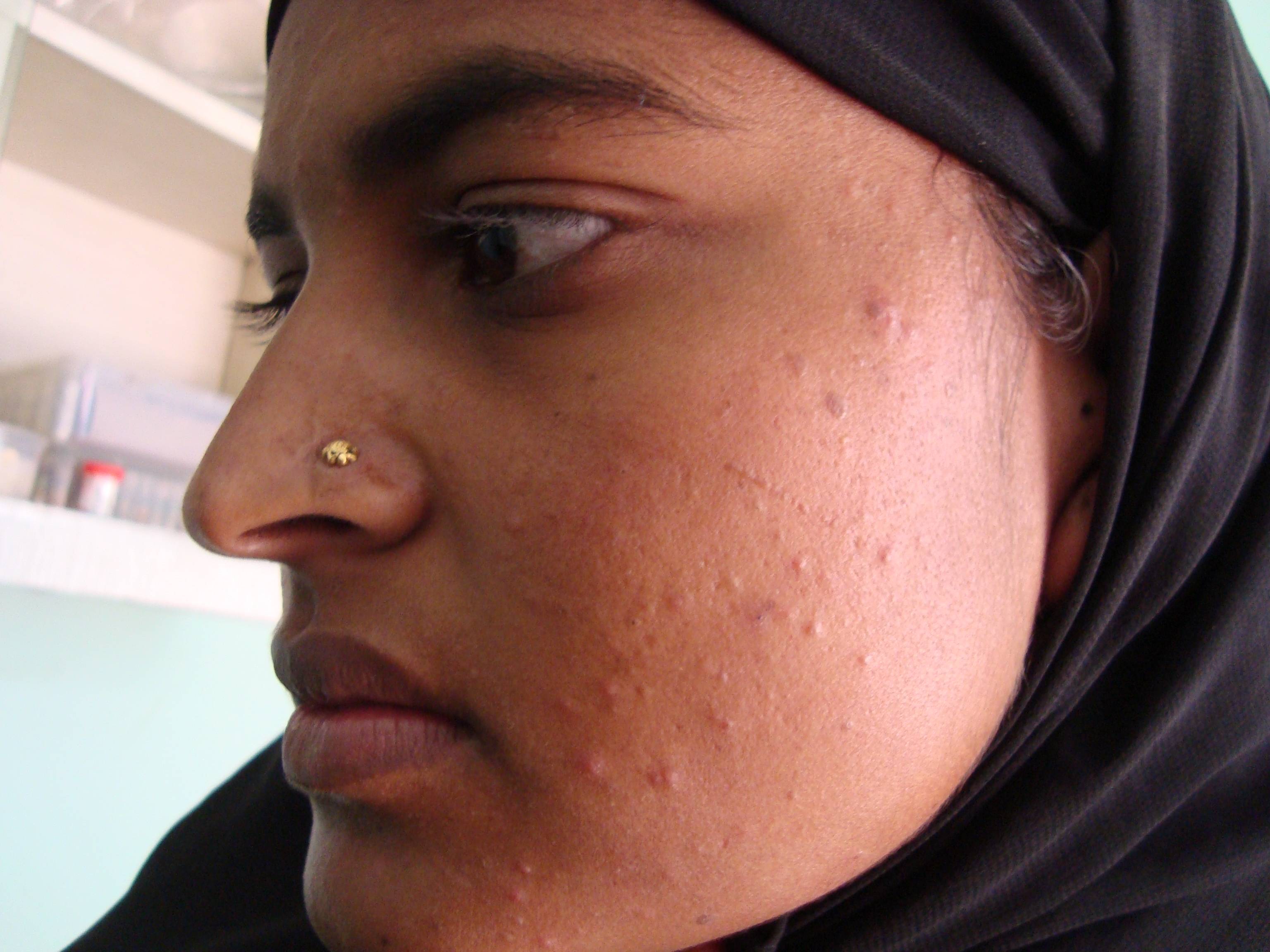 Chronic Hyper hydrosis (Sweat Problem) from last 2 - 3 years & Wart ...