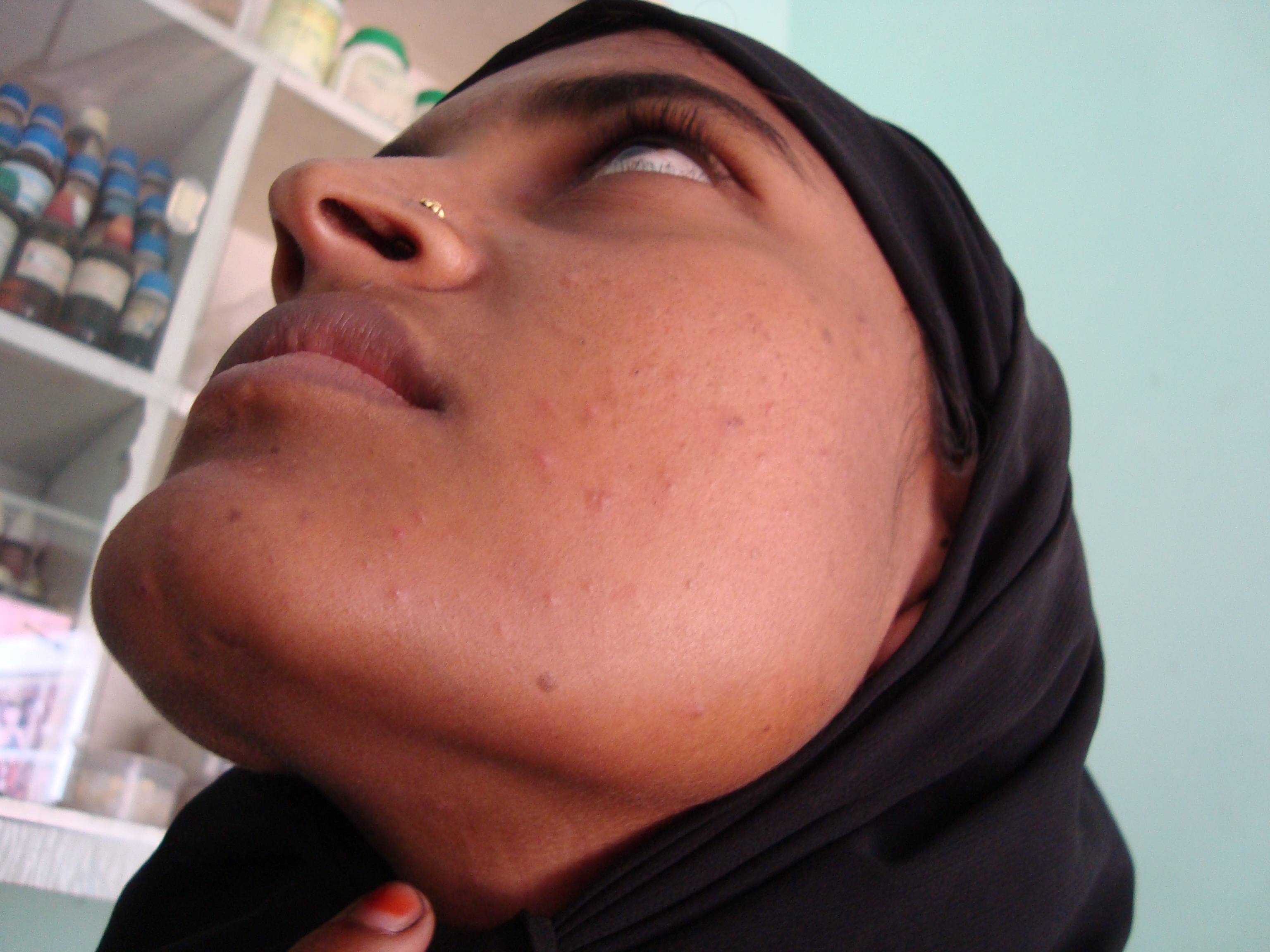 Chronic Hyper hydrosis (Sweat Problem) from last 2 - 3 years & Wart ...