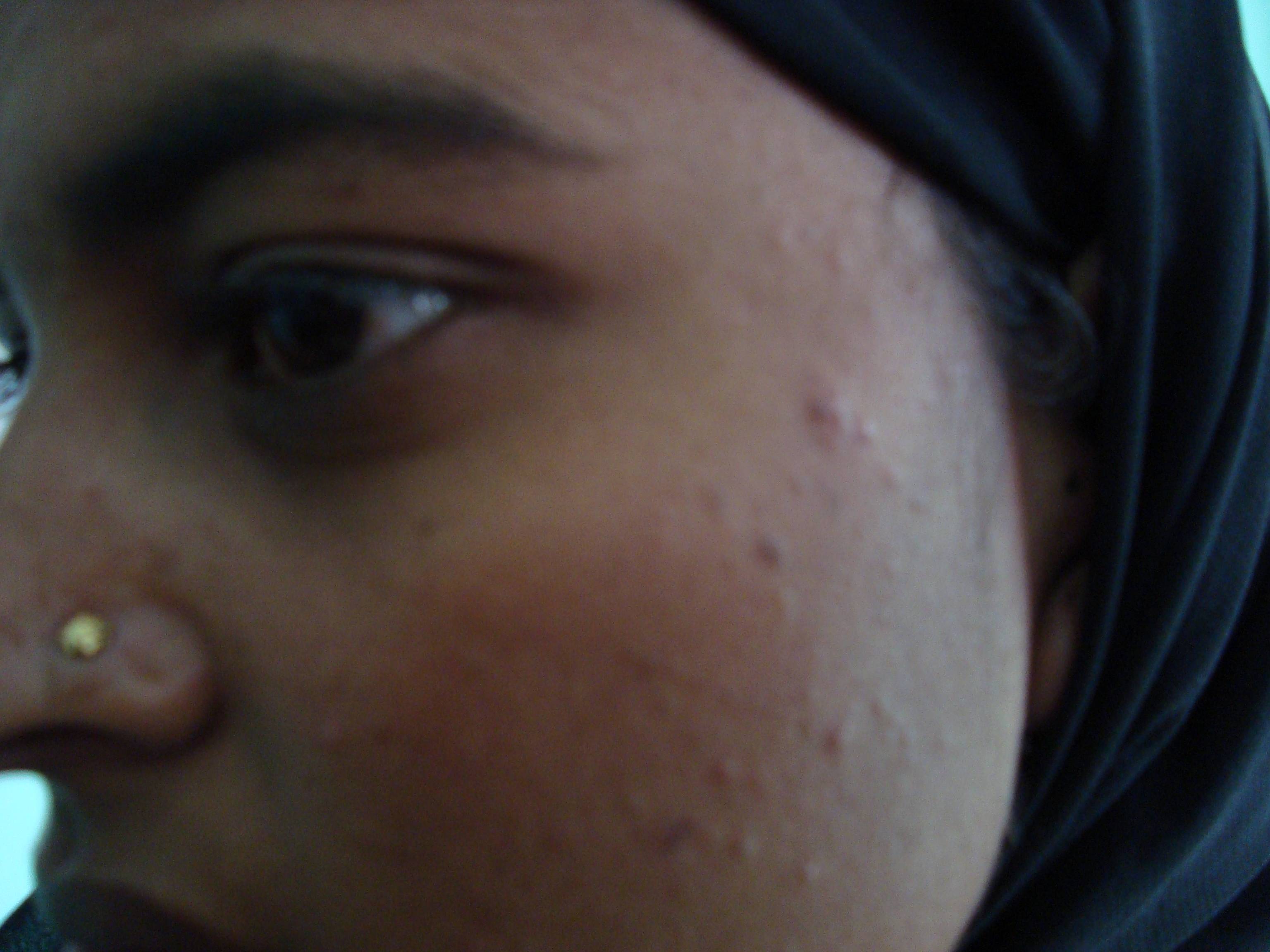 Chronic Hyper hydrosis (Sweat Problem) from last 2 - 3 years & Wart ...