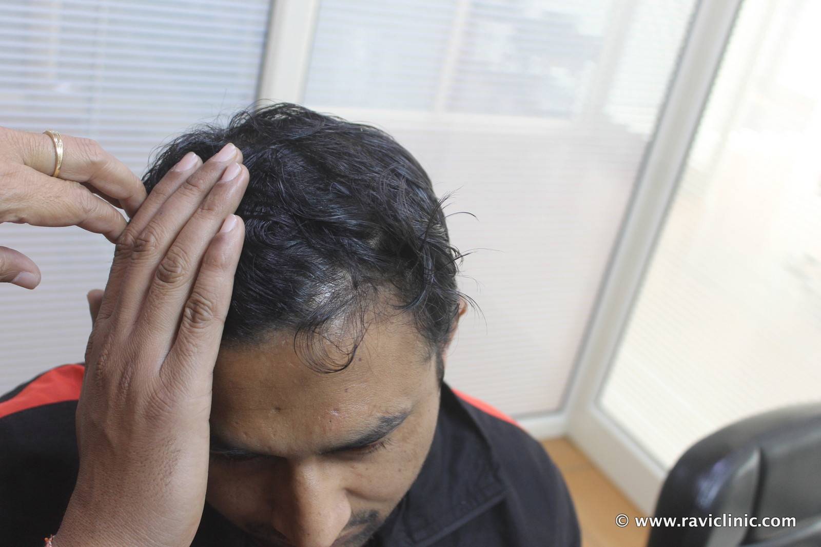 A classical case of Seborrhoeic Dermatitis, (4 - 5 years old case ...