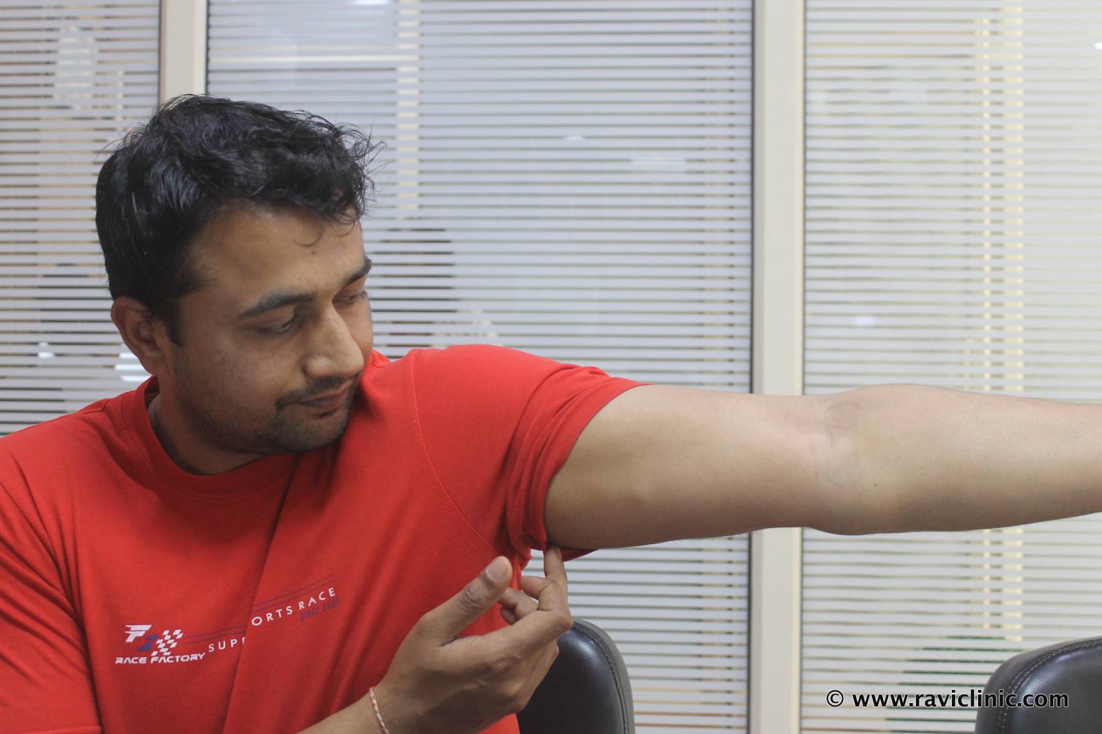 A classical case of Seborrhoeic Dermatitis, (4 - 5 years old case ...