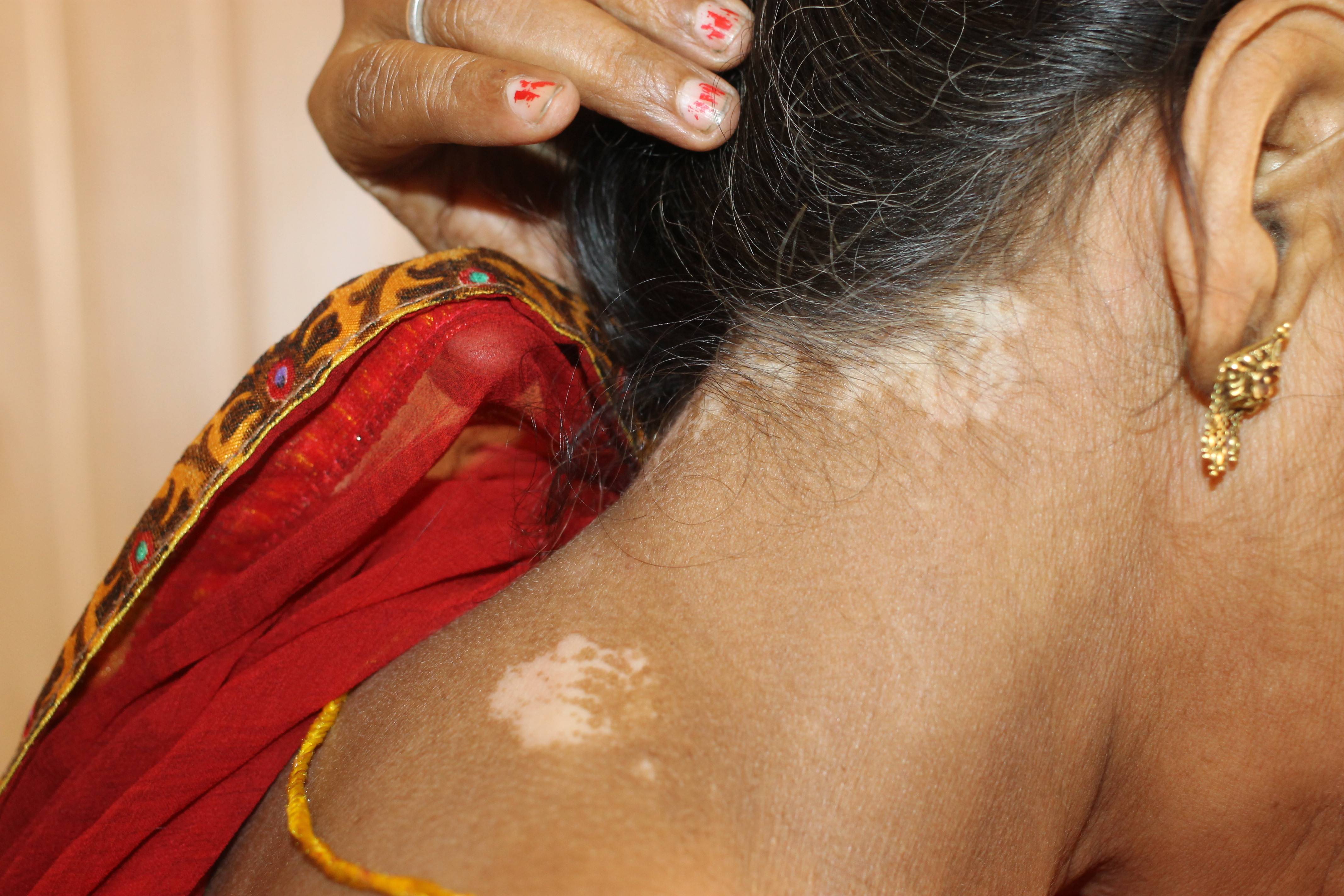 Case of Extensive Vitiligo Getting Cured with Classical homeopathy ...