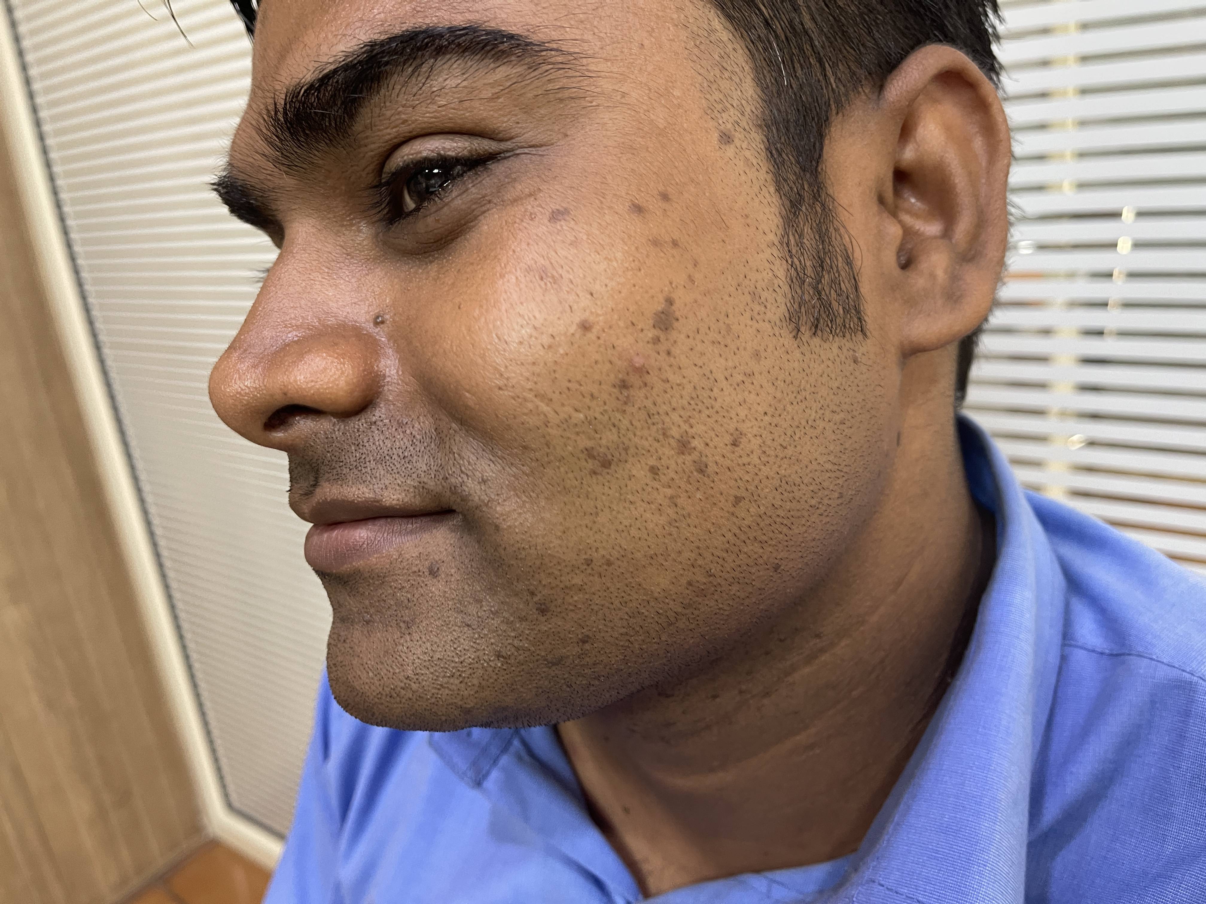 A case of Flat warts/ Verruca Plana for 4 years cured Who took a second ...