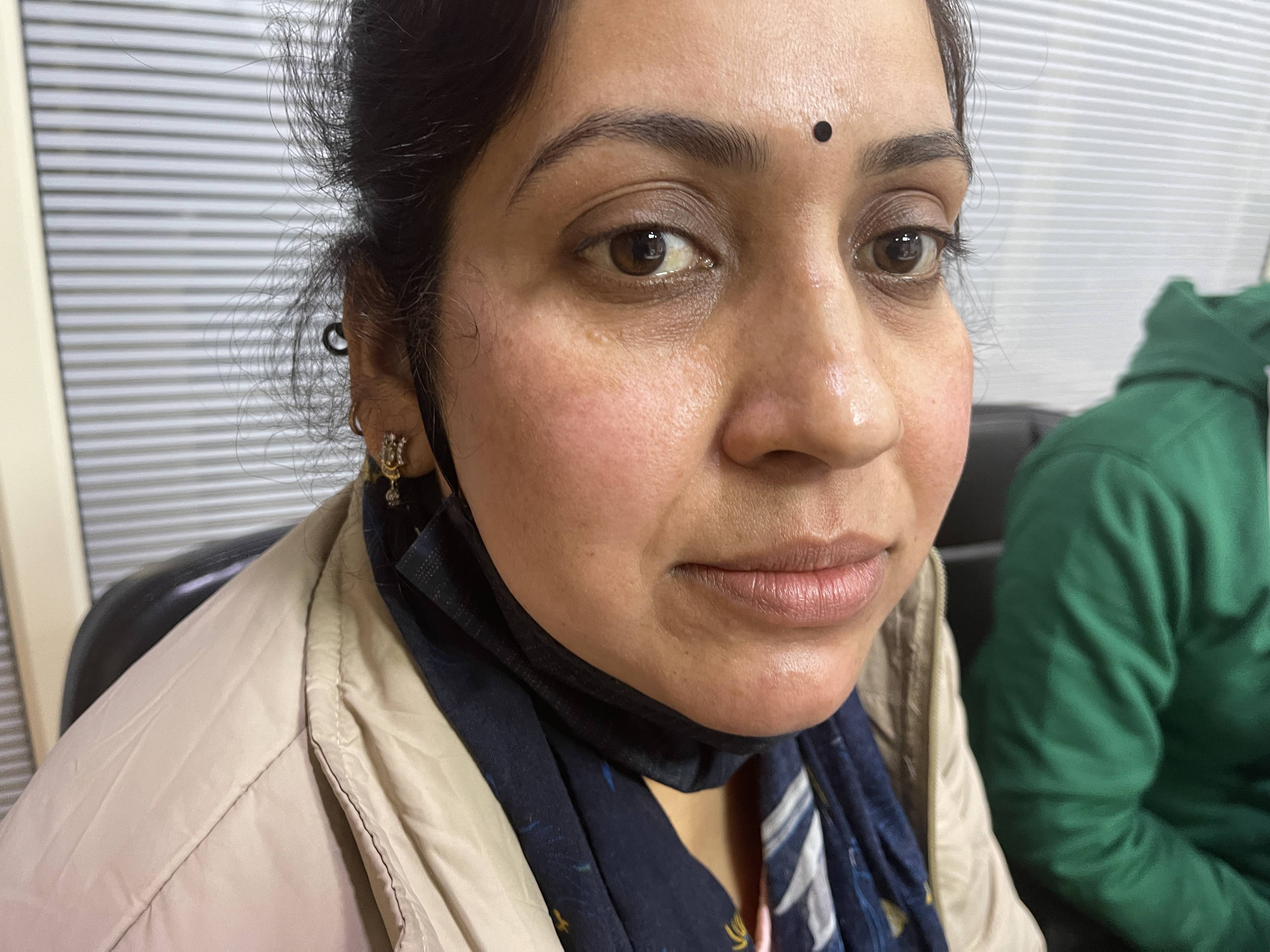 A case of Rosacea , sinusitis and Asthma recovered with Homeopathy ...