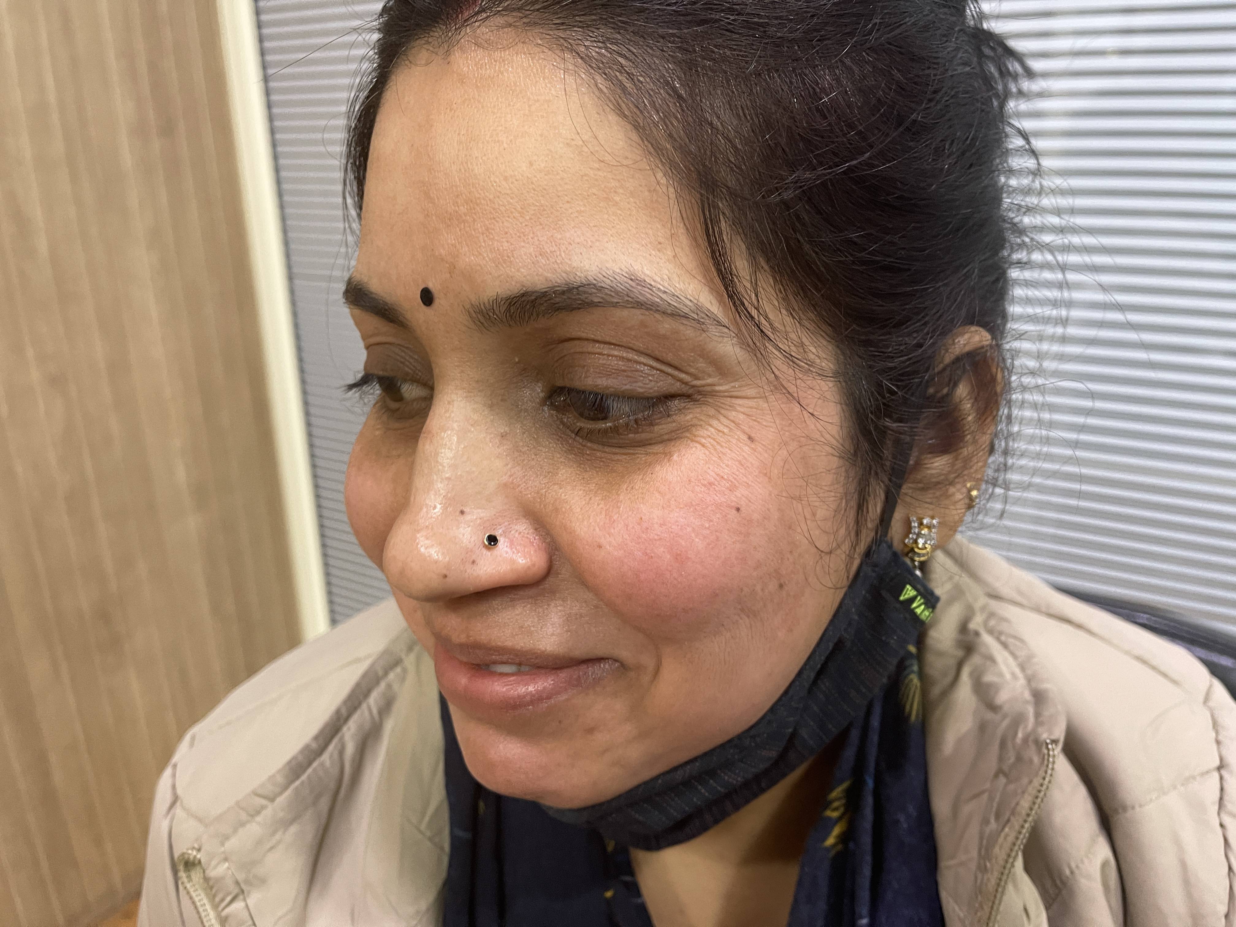 A case of Rosacea , sinusitis and Asthma recovered with Homeopathy ...