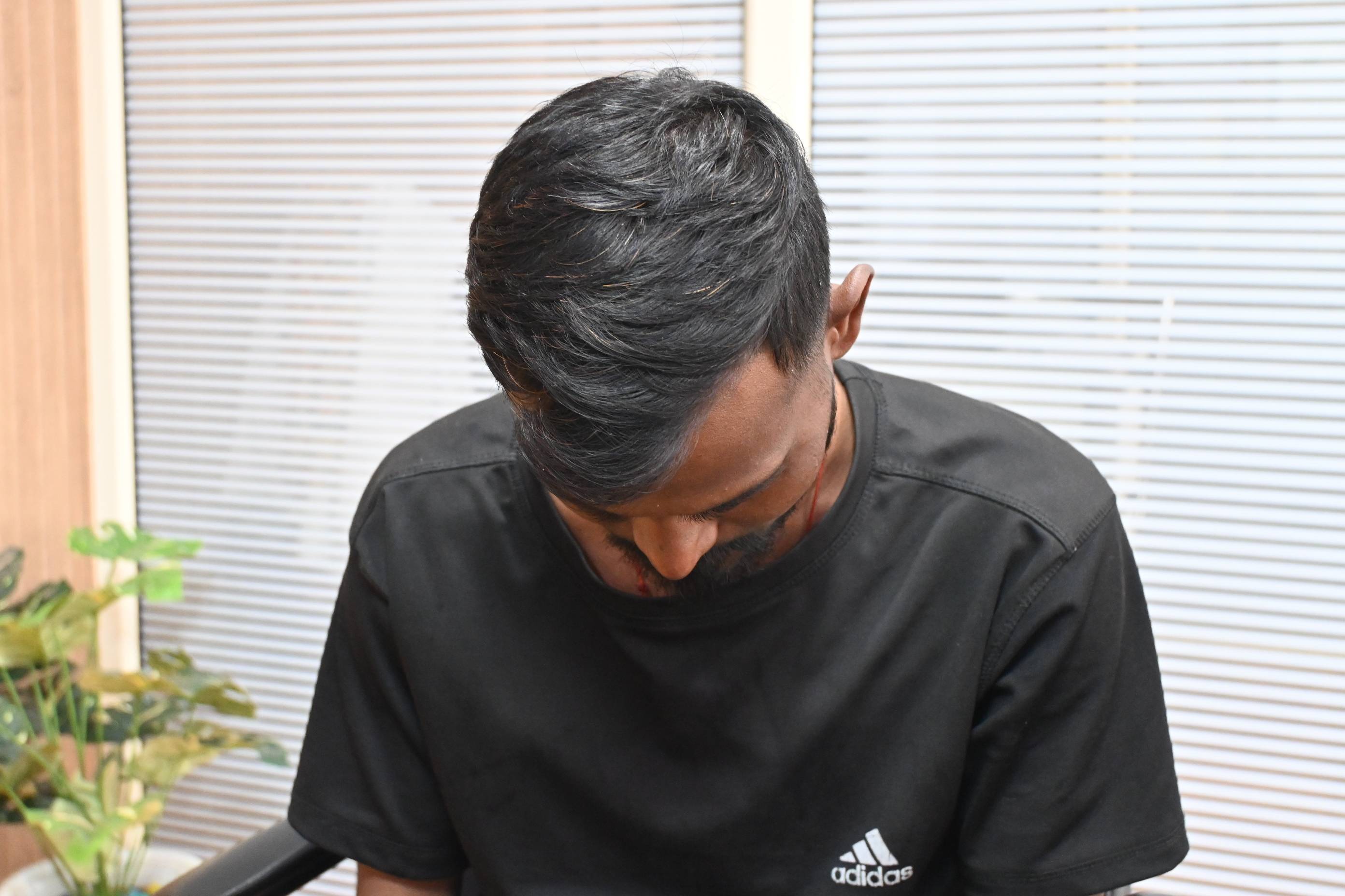 Seborrhoeic Dermatitis since 2018 Getting cured Case from Indore | Case ...