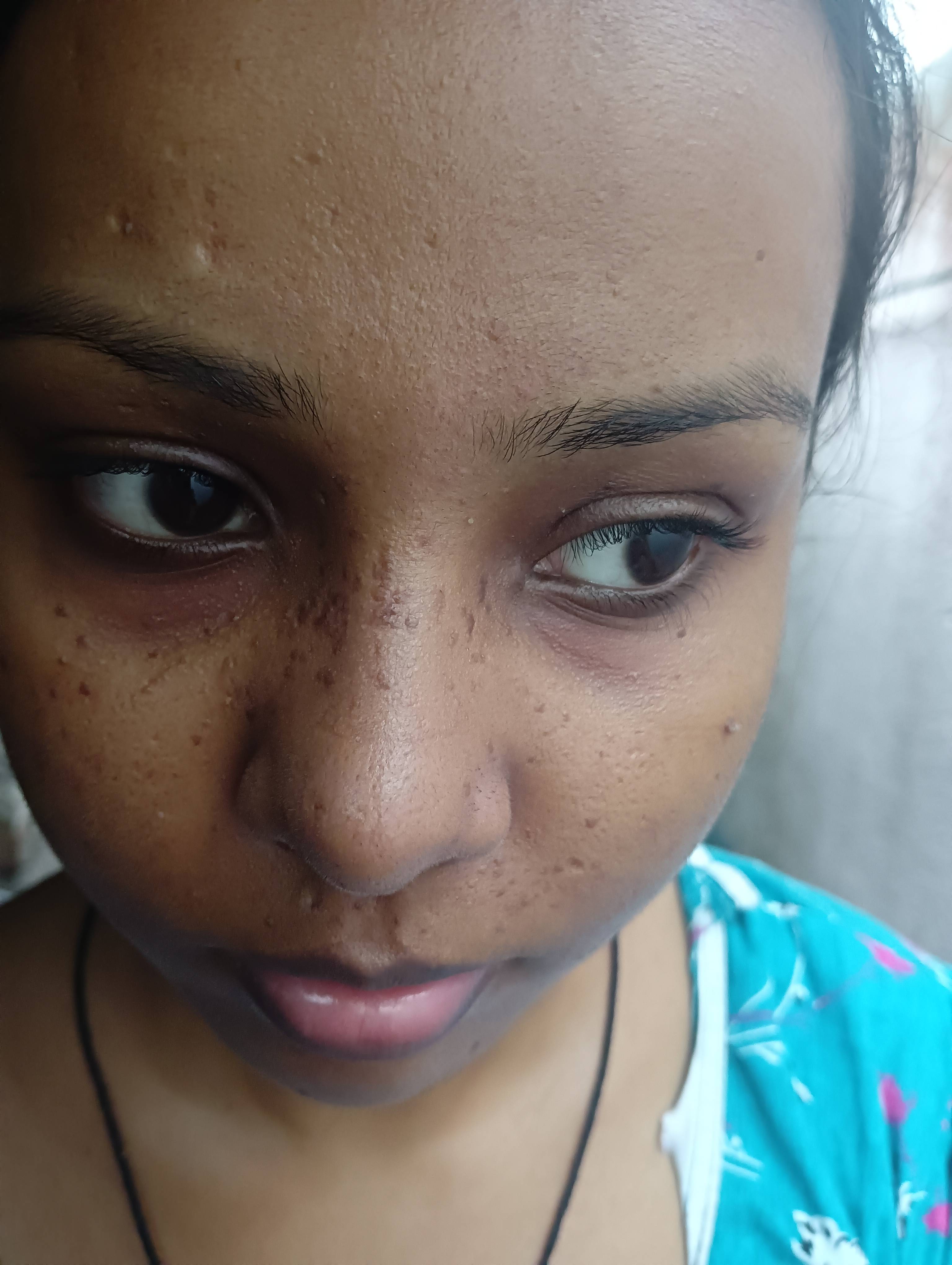 Overcoming Doubts and Achieving a Cure for Persistent Facial Warts for ...