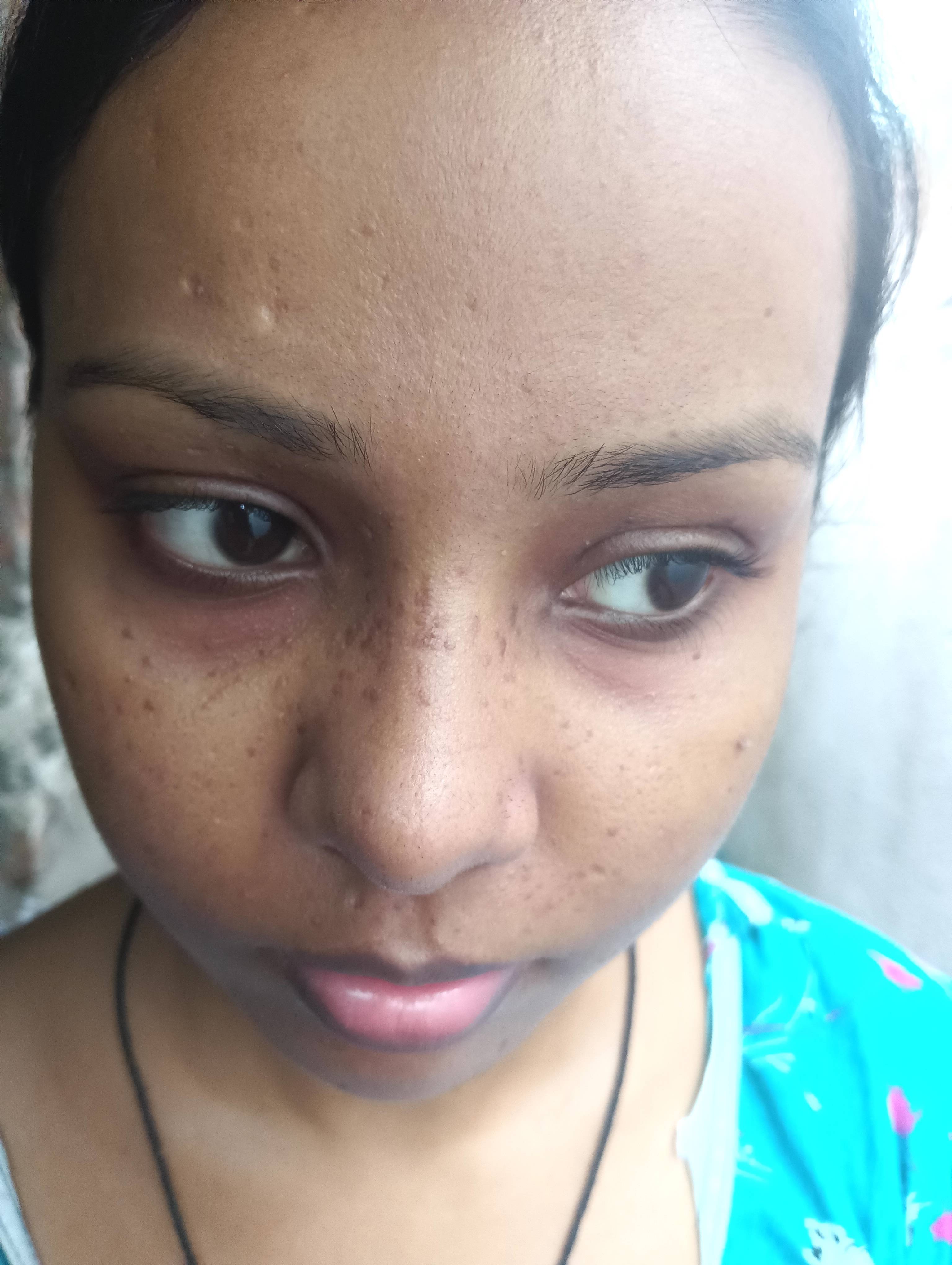 Overcoming Doubts and Achieving a Cure for Persistent Facial Warts for ...