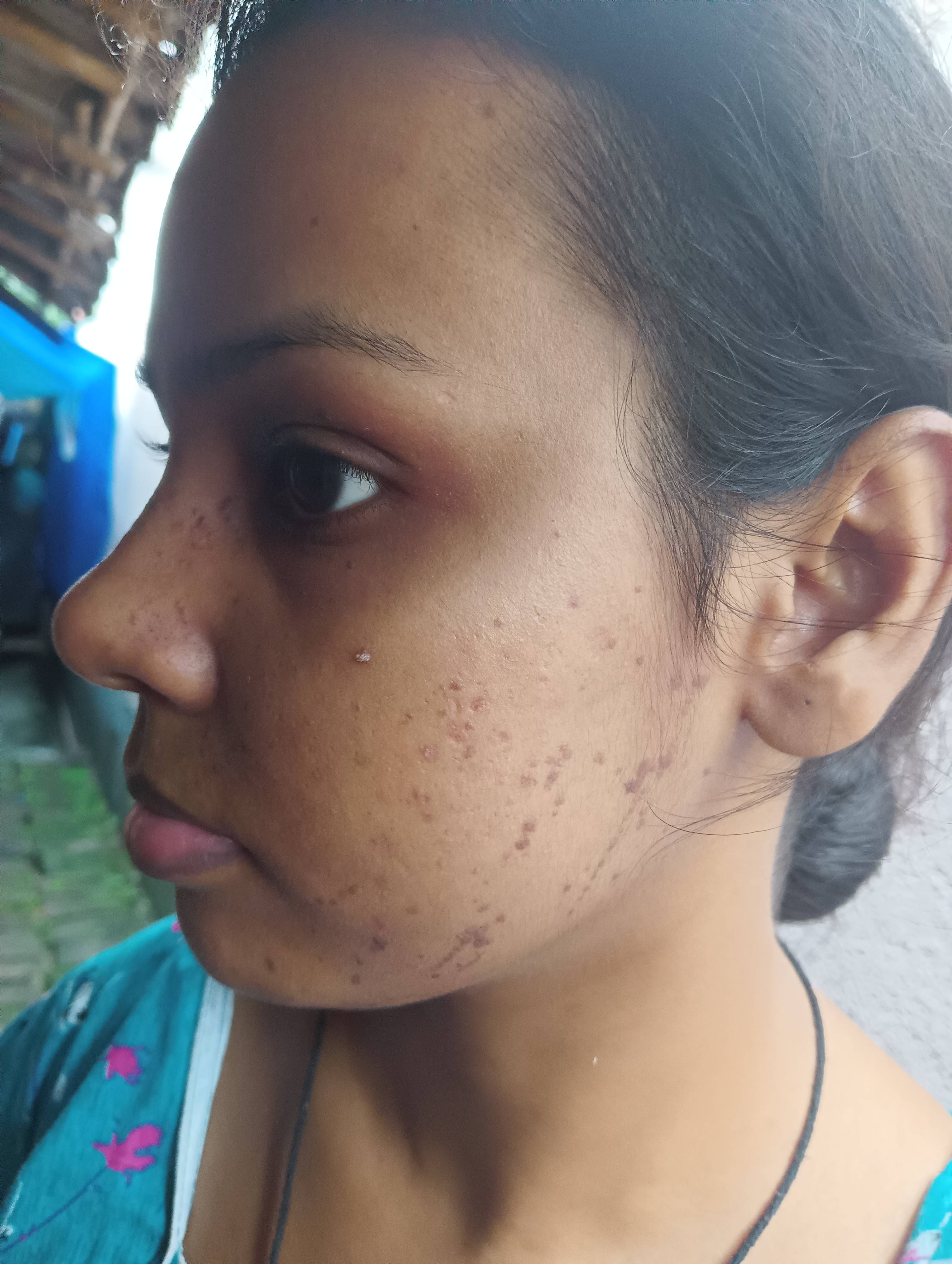 Overcoming Doubts and Achieving a Cure for Persistent Facial Warts for ...