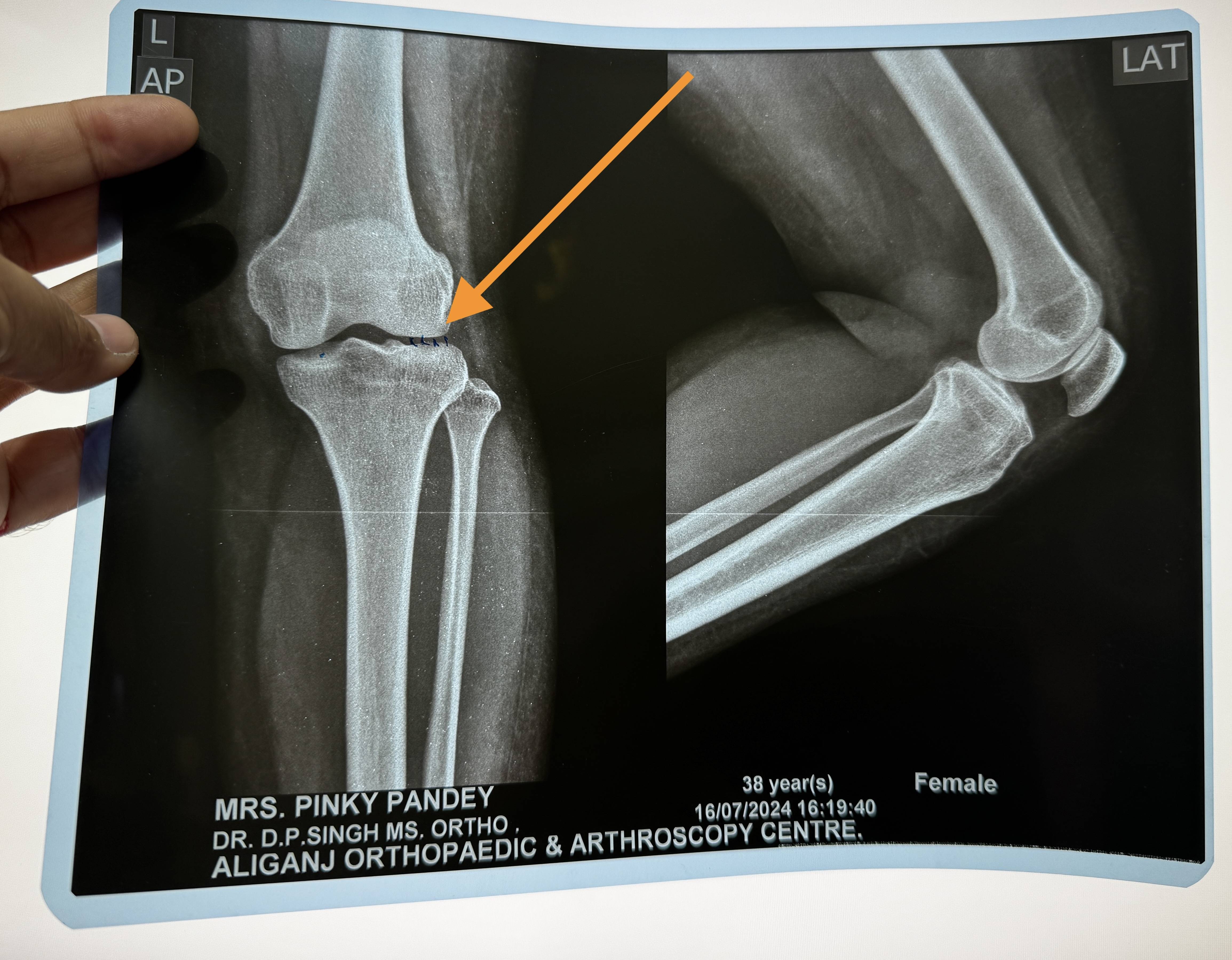 Osteoarthritis and Slipped Disk can be cured with Homeopathy | Case Study