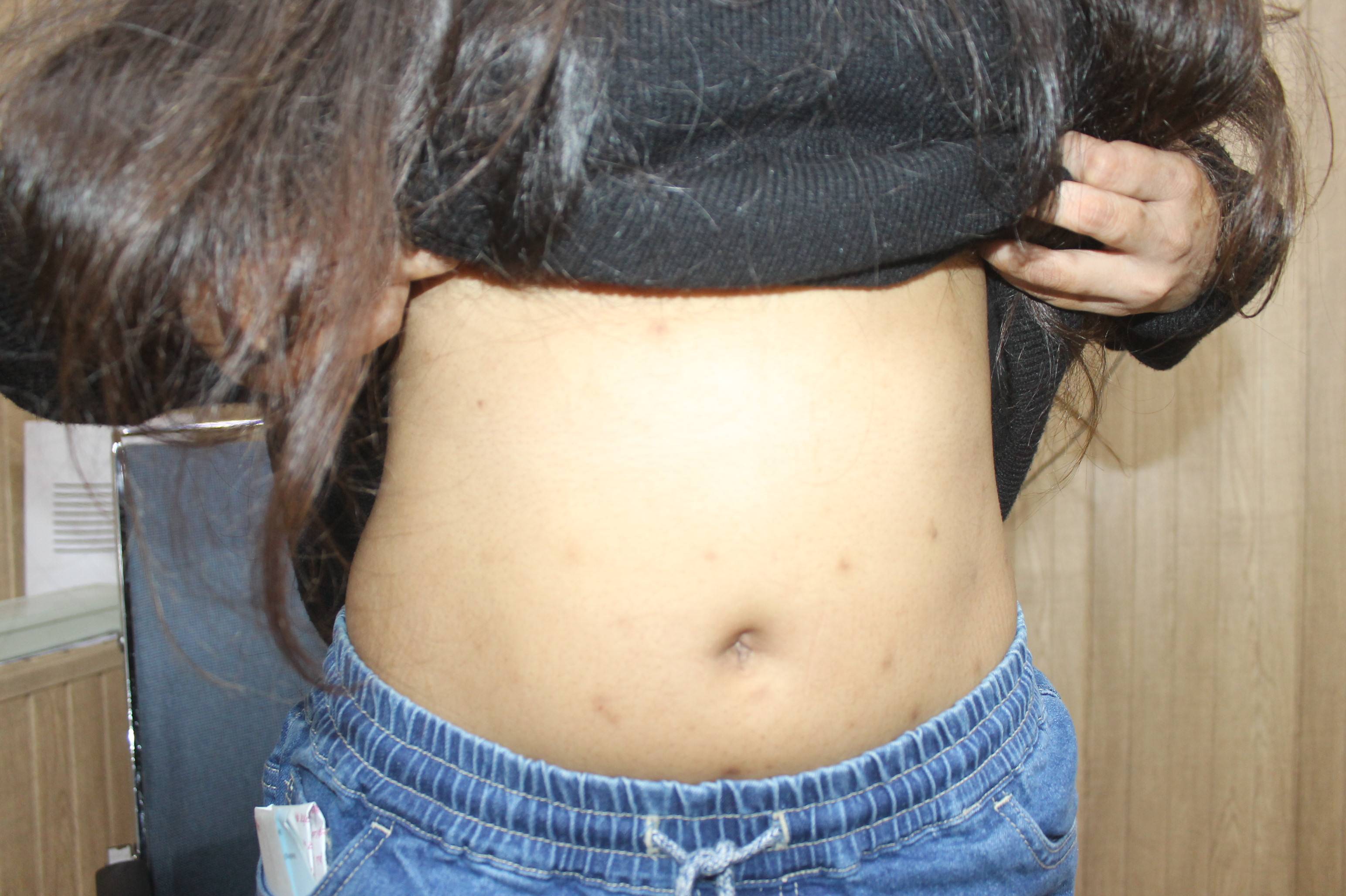 Observed Recovery in case of Rare Disease: Prurigo Nodularis and Urticaria with homeopathy ...