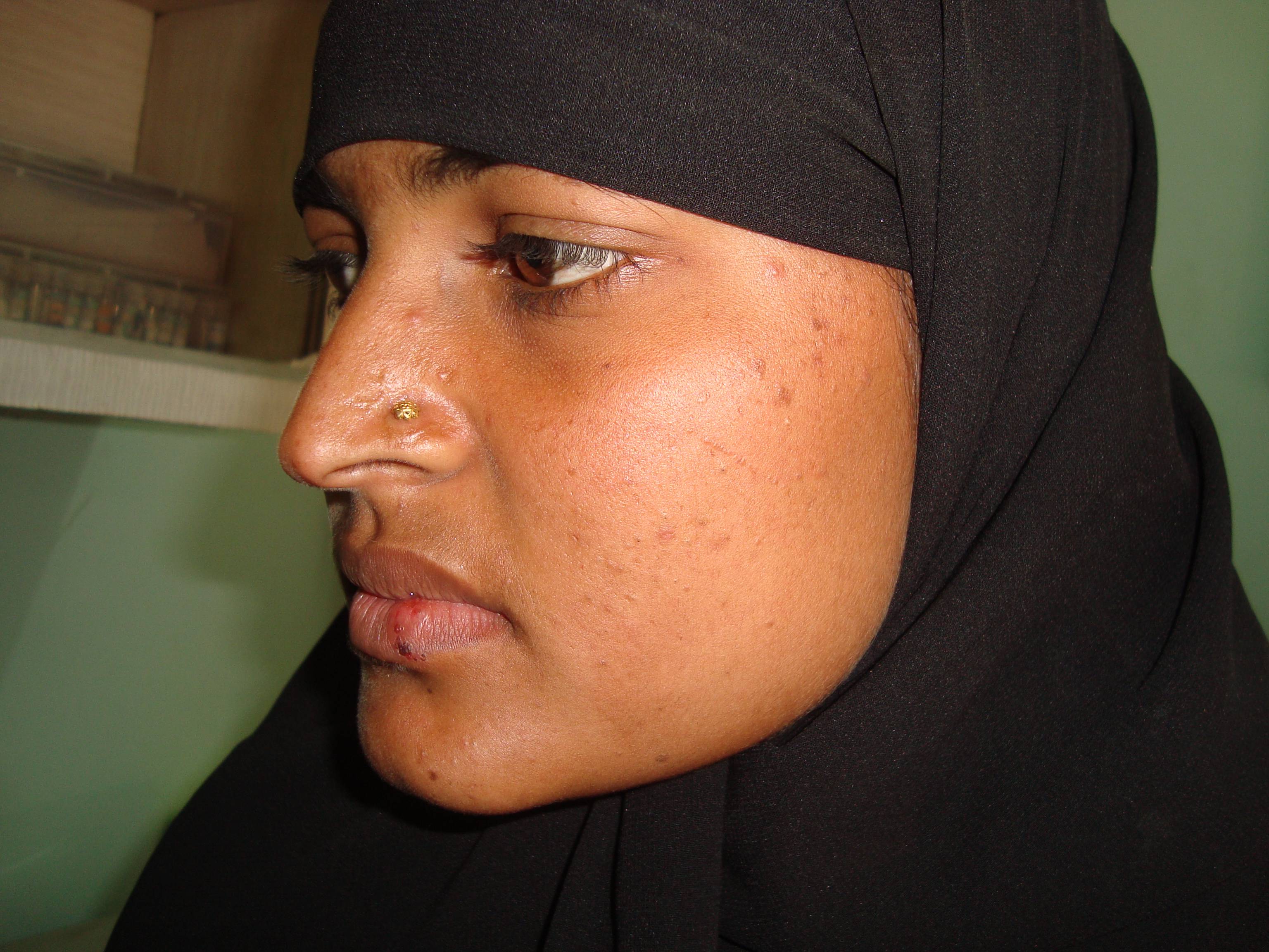 Chronic Hyper hydrosis (Sweat Problem) from last 2 - 3 years & Wart ...