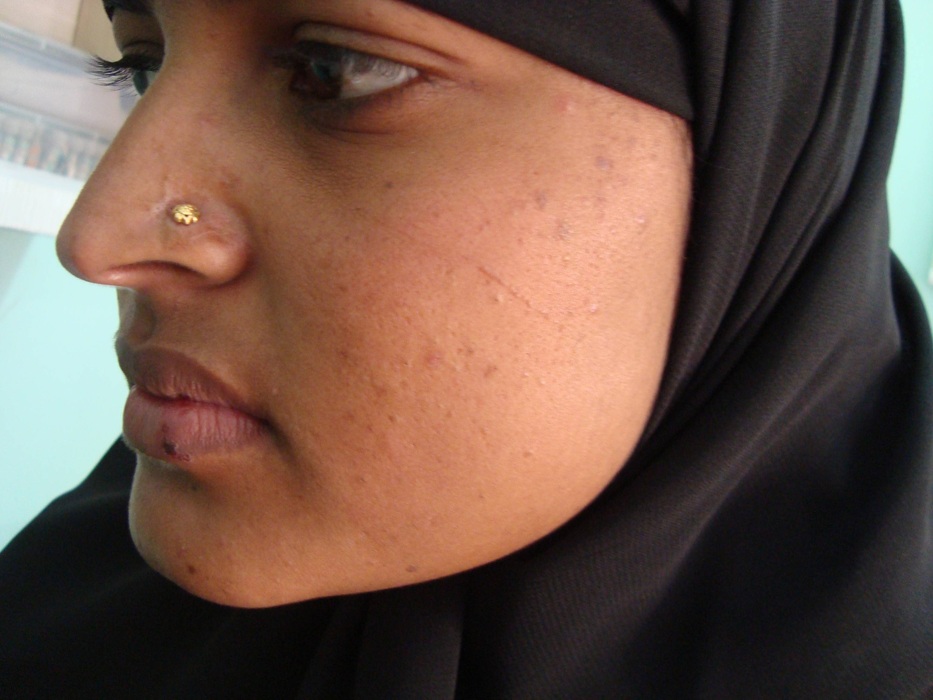 Chronic Hyper hydrosis (Sweat Problem) from last 2 - 3 years & Wart ...