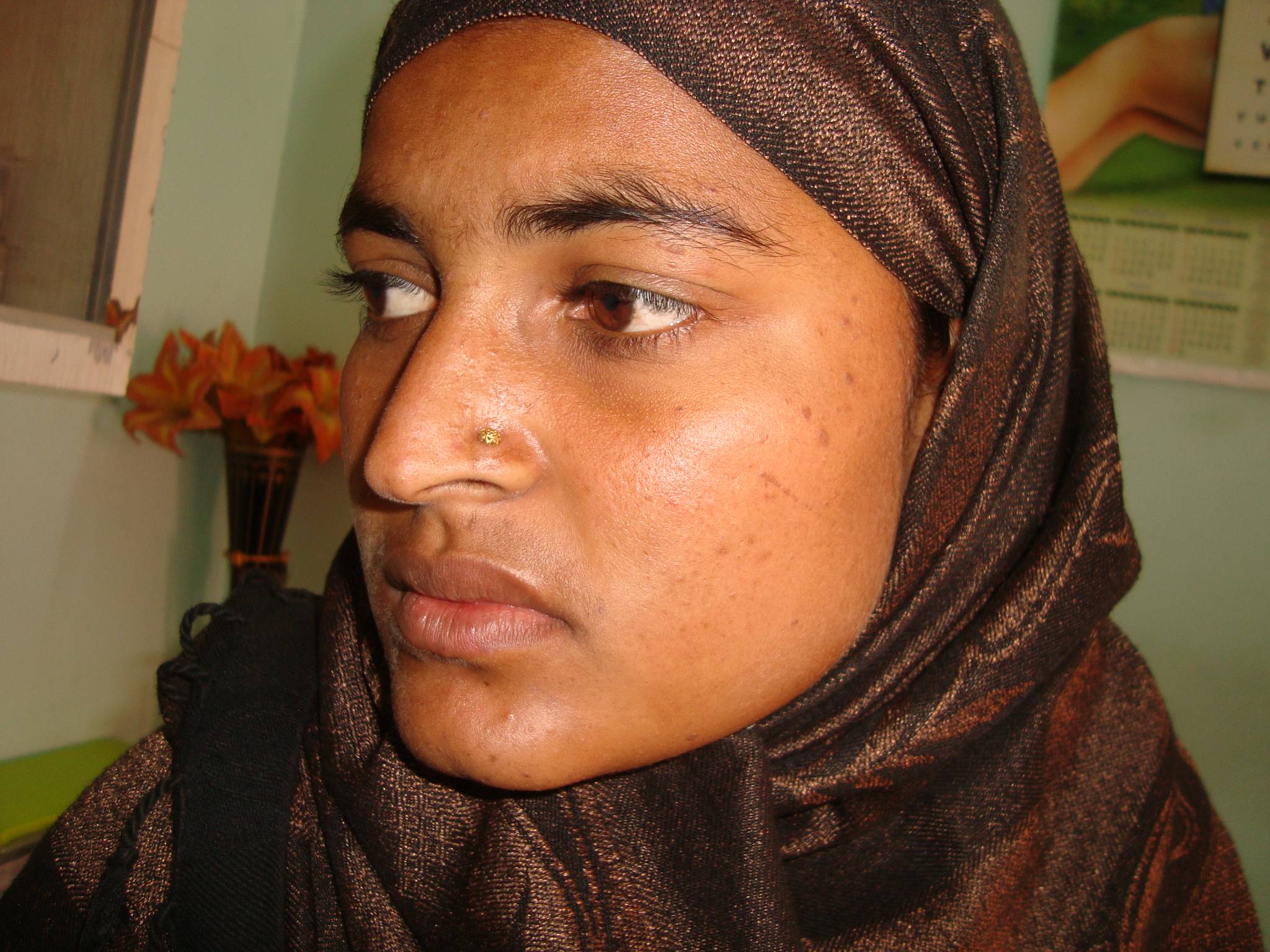 Chronic Hyper hydrosis (Sweat Problem) from last 2 - 3 years & Wart ...