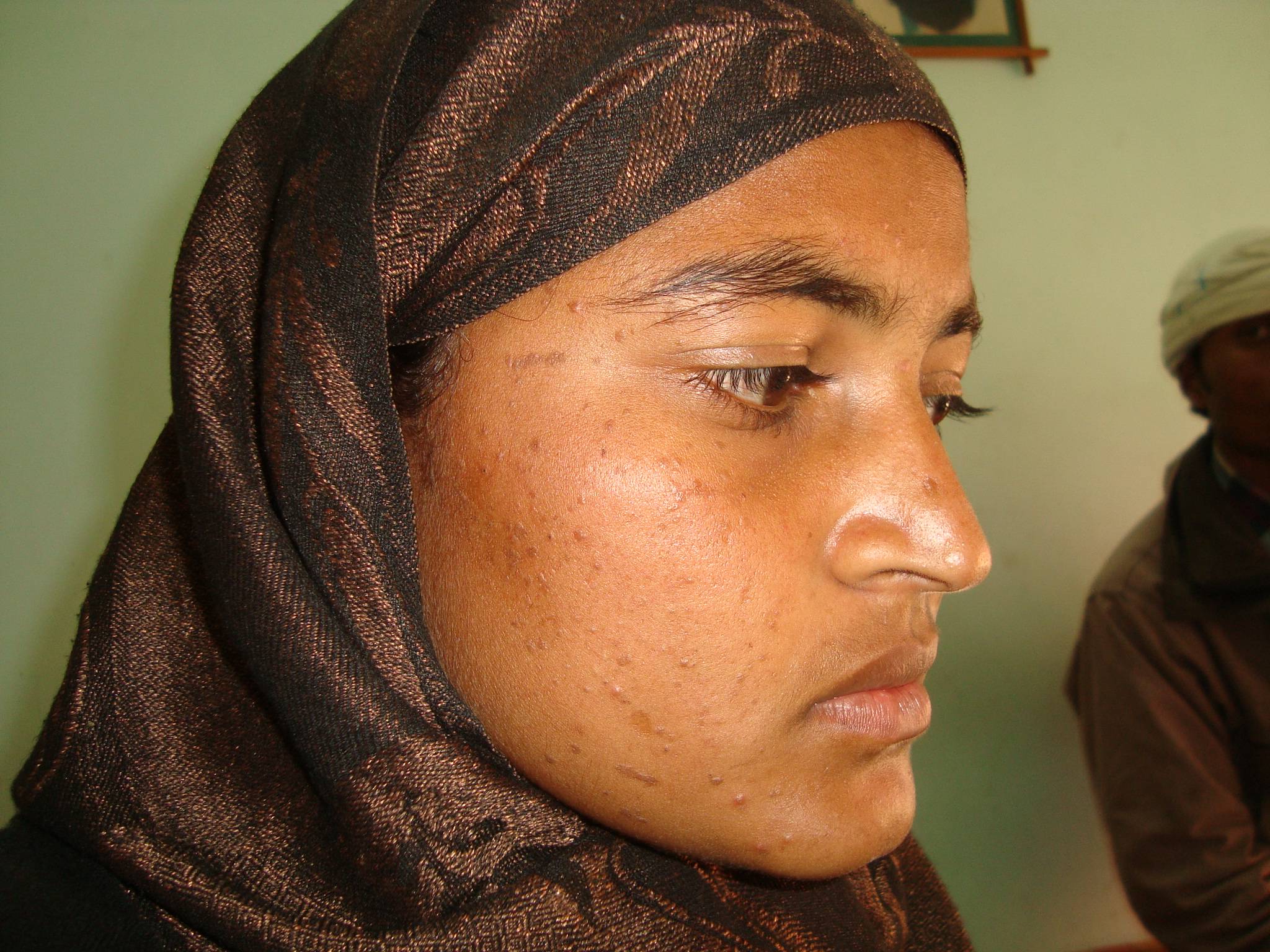 Chronic Hyper hydrosis (Sweat Problem) from last 2 - 3 years & Wart ...