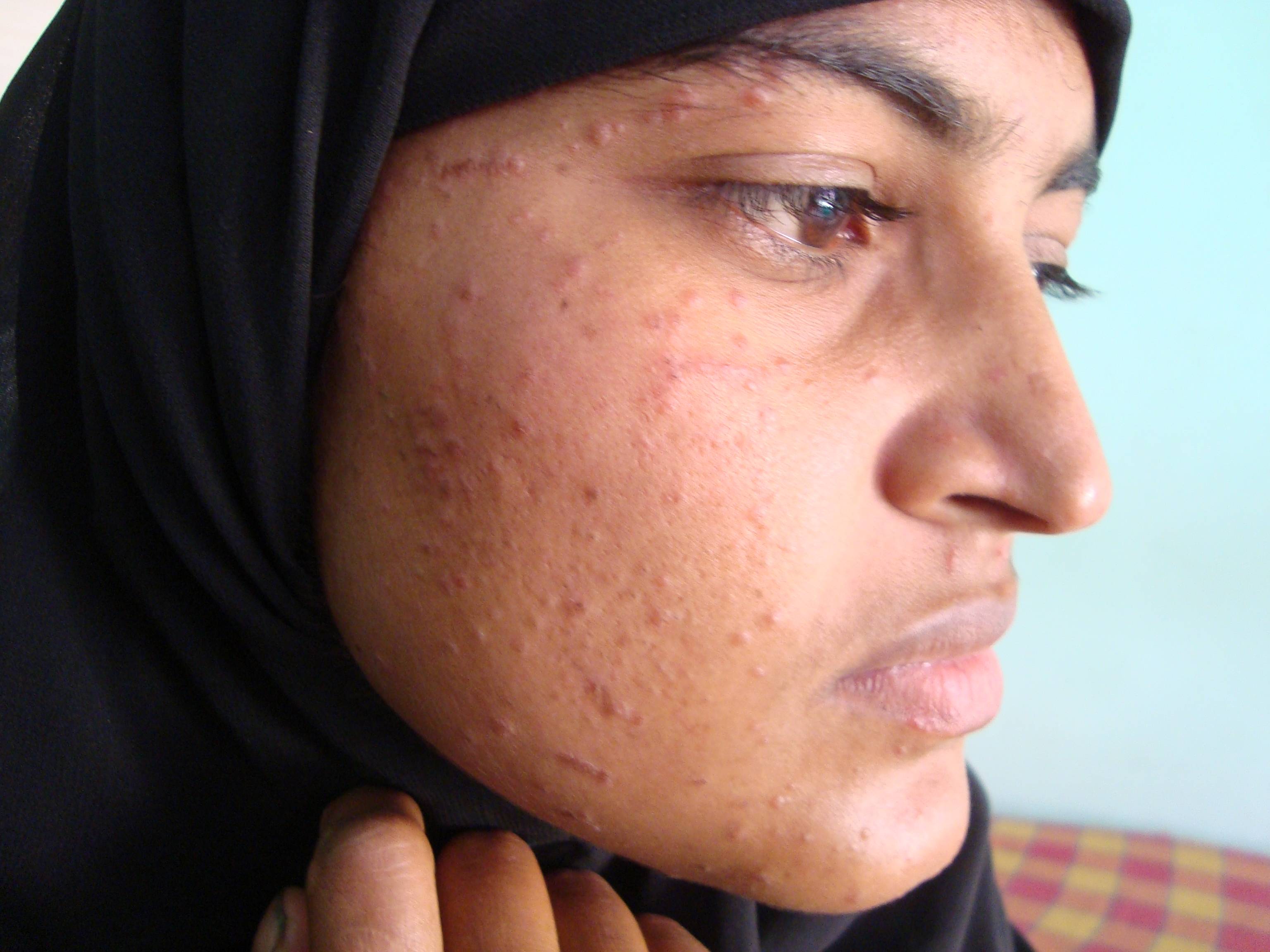 Chronic Hyper hydrosis (Sweat Problem) from last 2 - 3 years & Wart ...