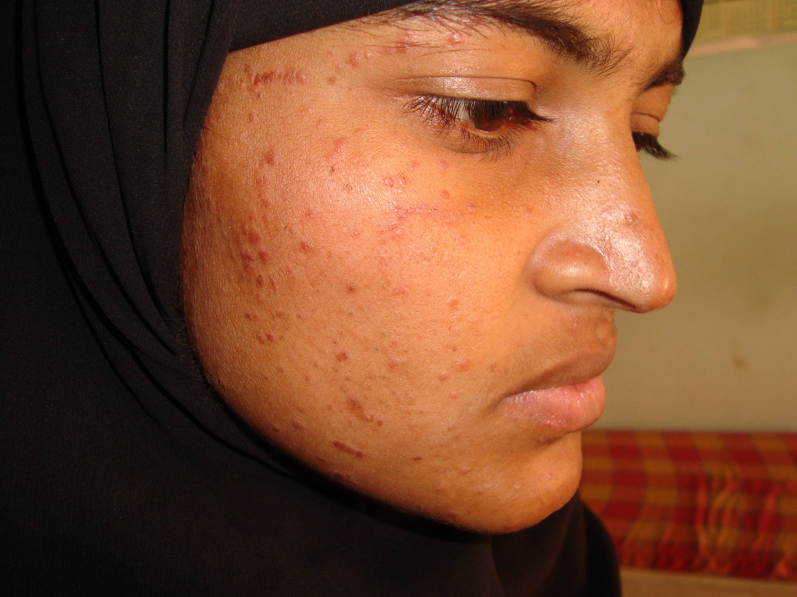 Chronic Hyper hydrosis (Sweat Problem) from last 2 - 3 years & Wart ...