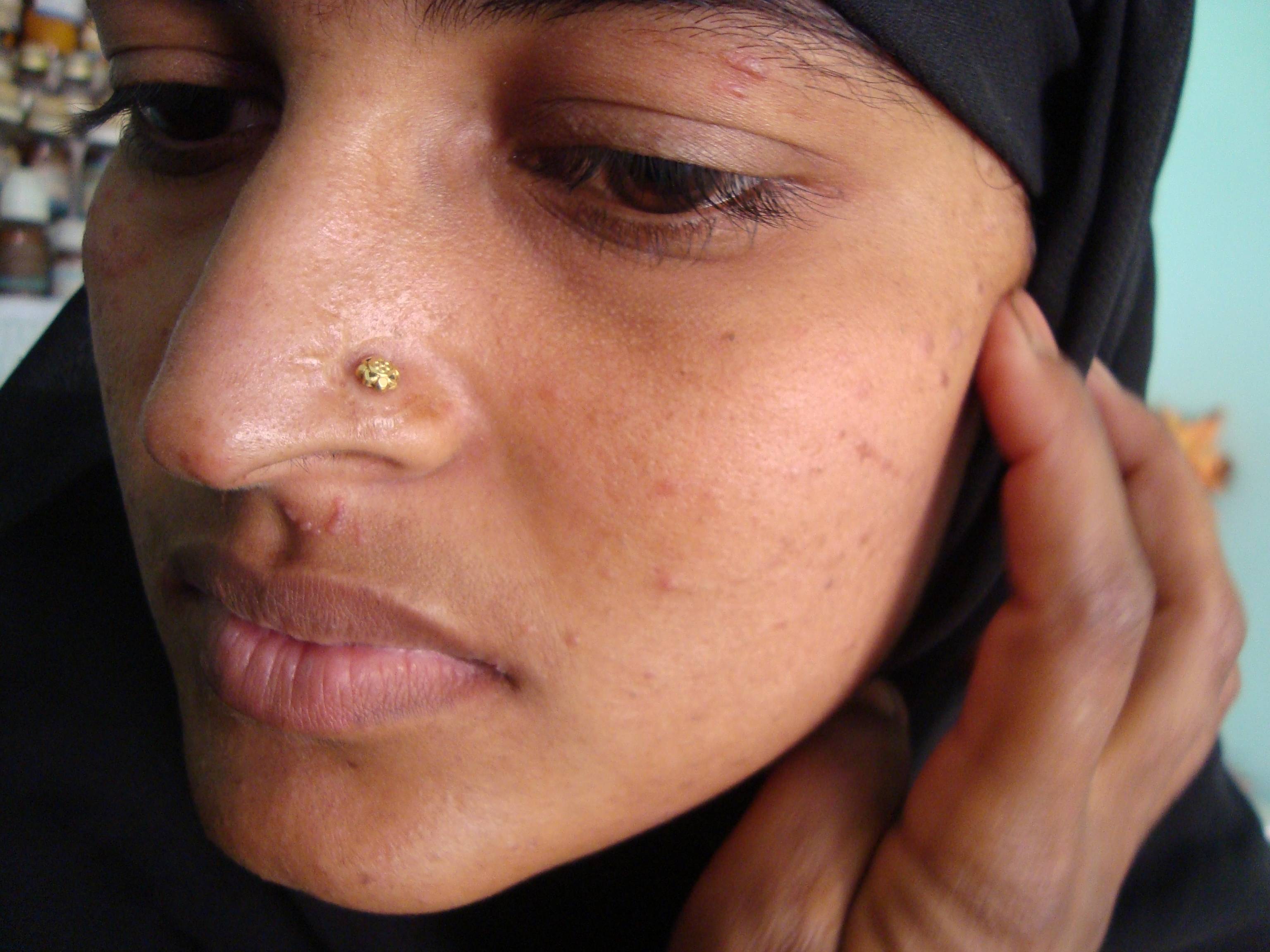 Chronic Hyper hydrosis (Sweat Problem) from last 2 - 3 years & Wart ...