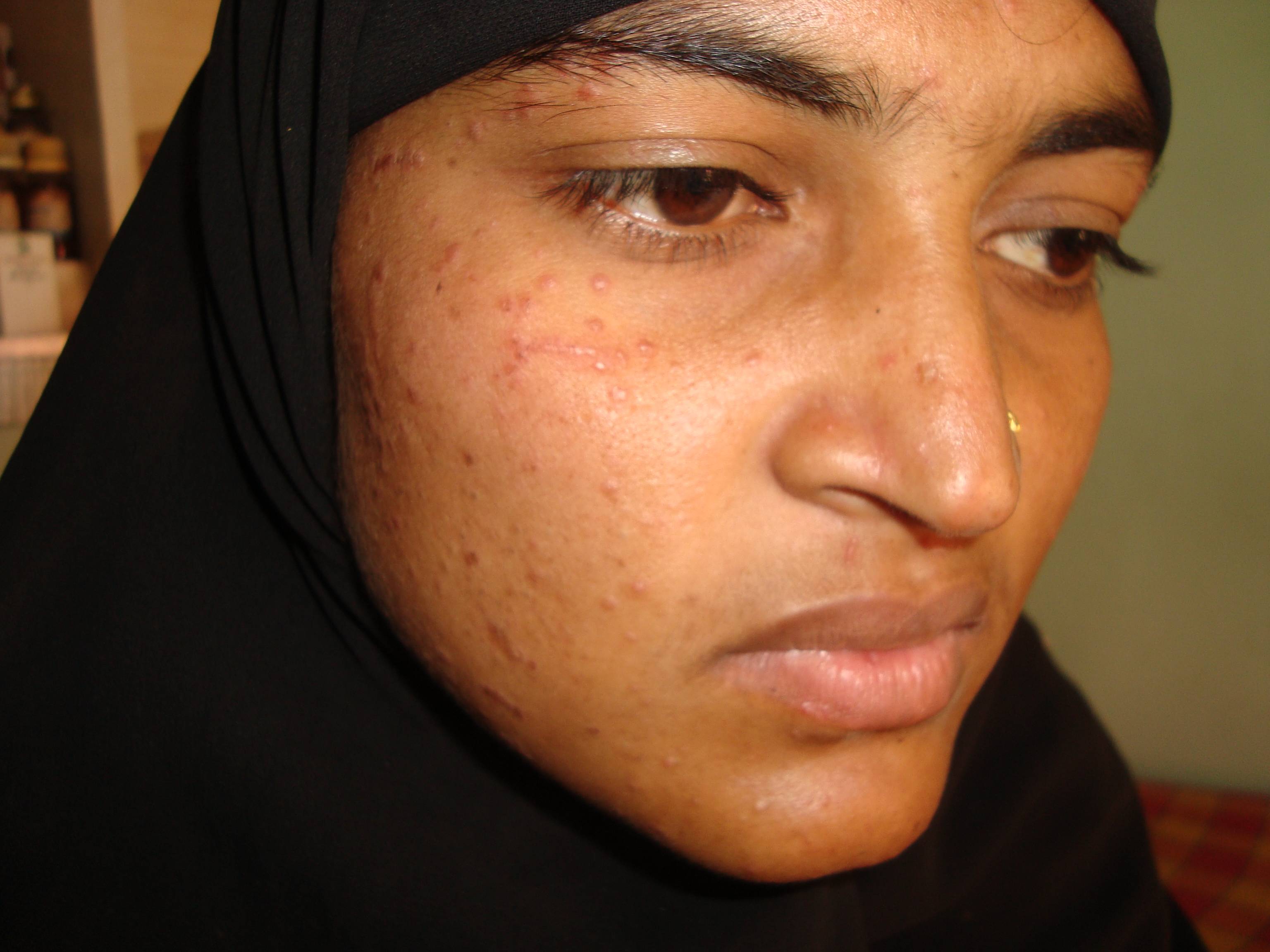 Chronic Hyper hydrosis (Sweat Problem) from last 2 - 3 years & Wart ...