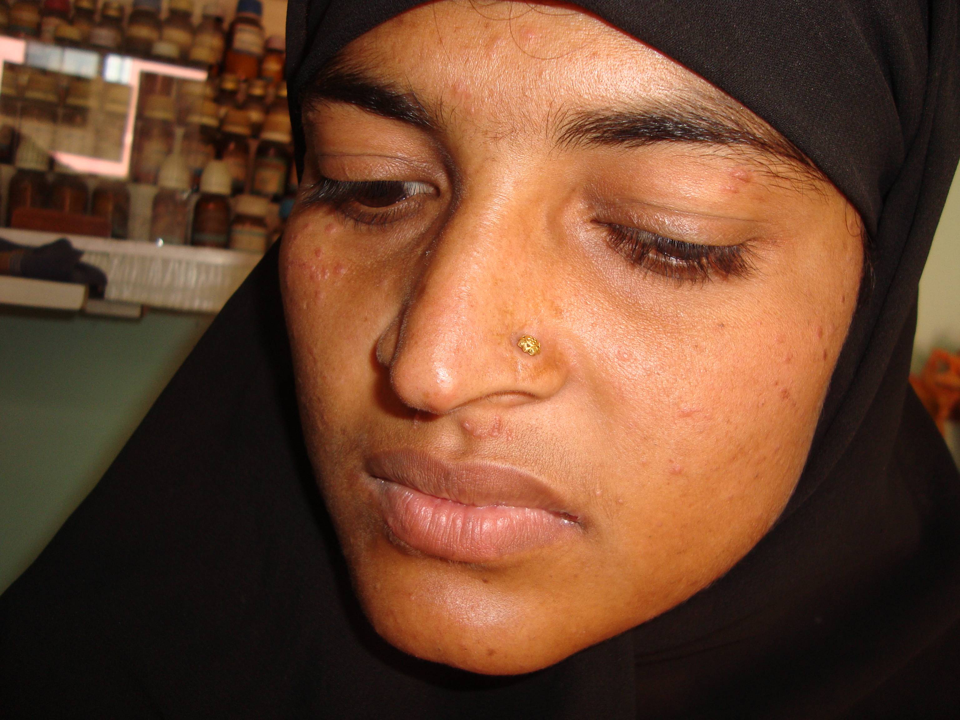 Chronic Hyper hydrosis (Sweat Problem) from last 2 - 3 years & Wart ...