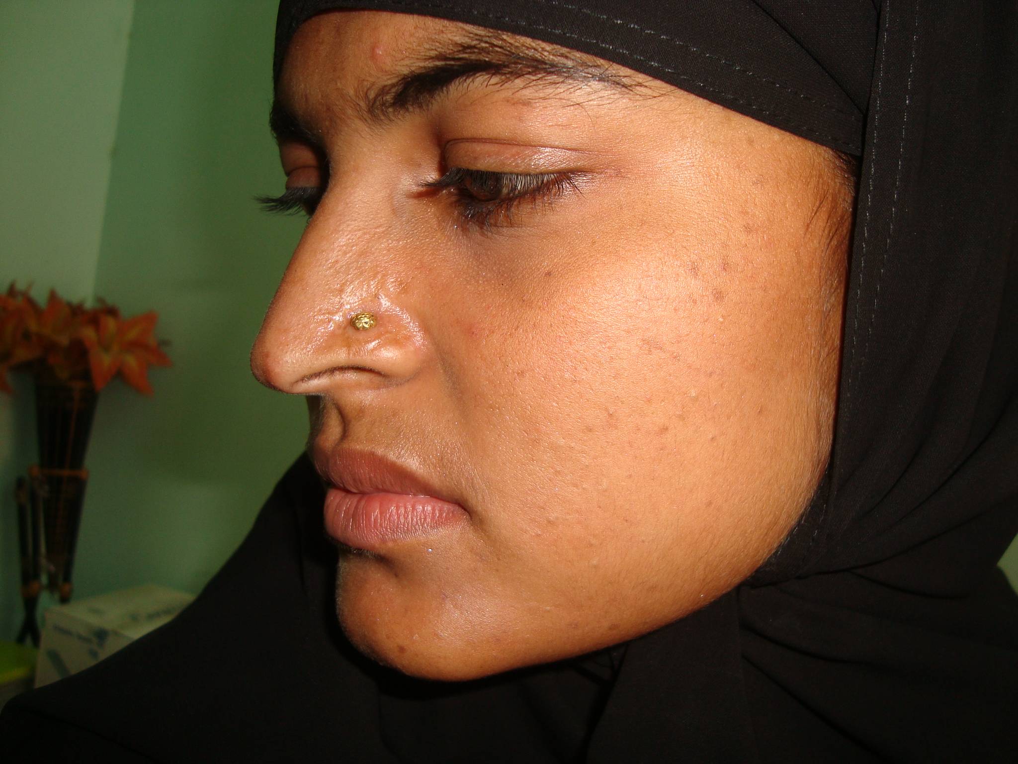 Chronic Hyper hydrosis (Sweat Problem) from last 2 - 3 years & Wart ...