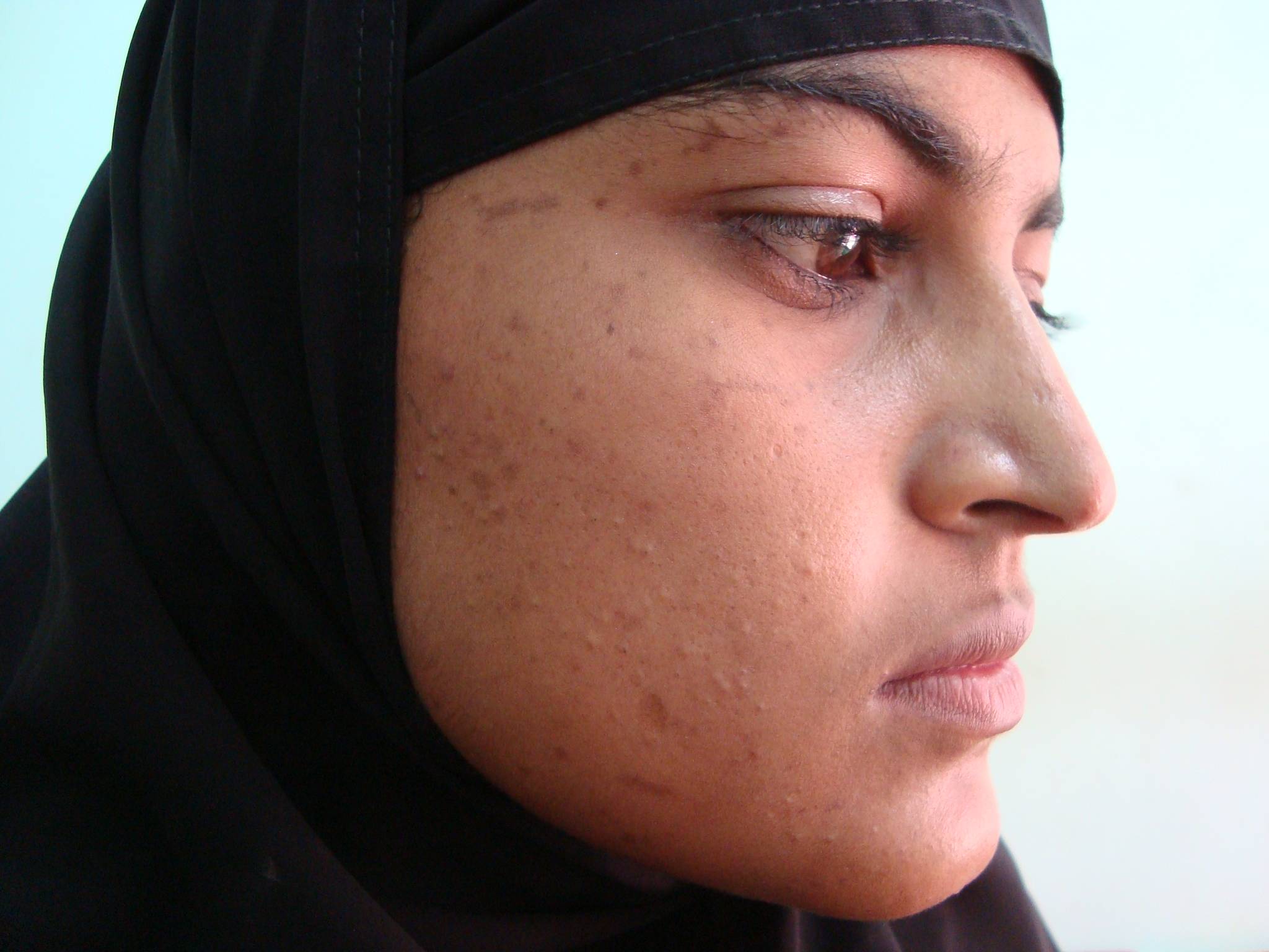 Chronic Hyper hydrosis (Sweat Problem) from last 2 - 3 years & Wart ...