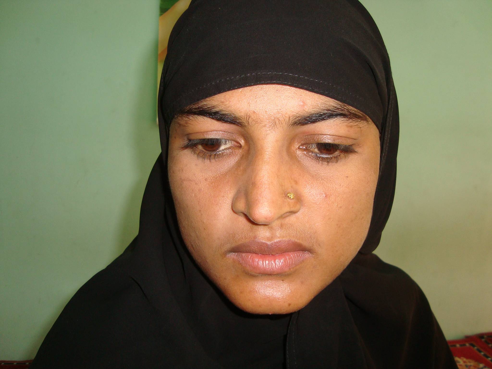 Chronic Hyper hydrosis (Sweat Problem) from last 2 - 3 years & Wart ...