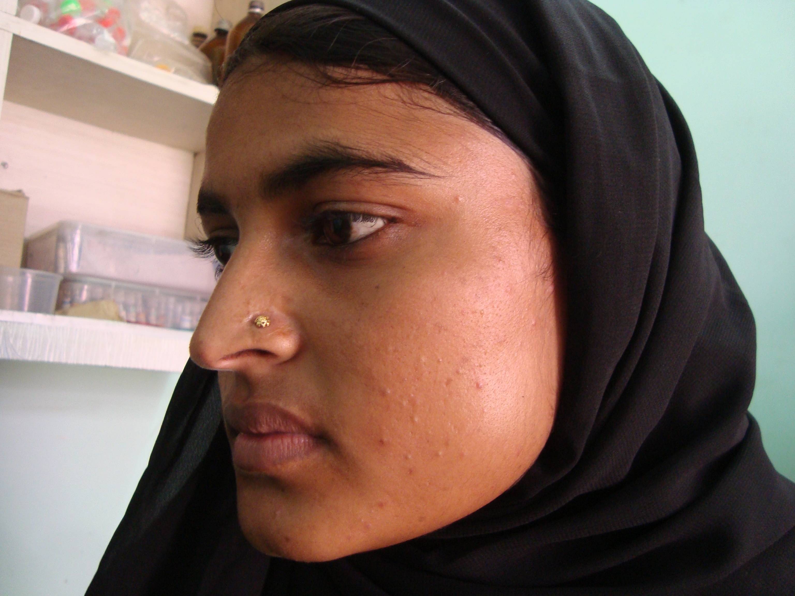 Chronic Hyper hydrosis (Sweat Problem) from last 2 - 3 years & Wart ...