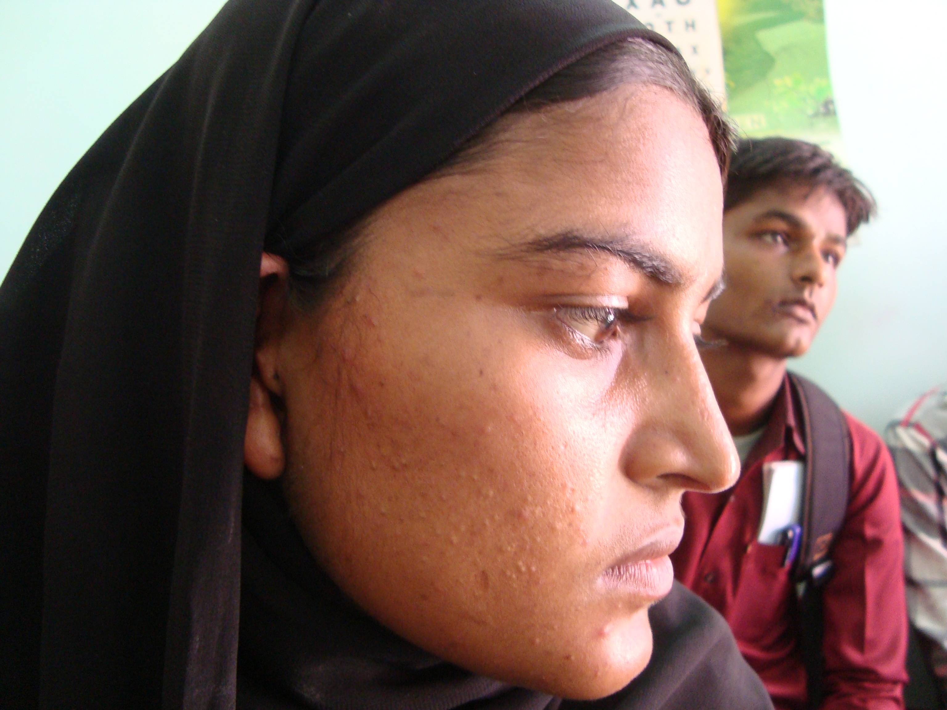 Chronic Hyper hydrosis (Sweat Problem) from last 2 - 3 years & Wart ...