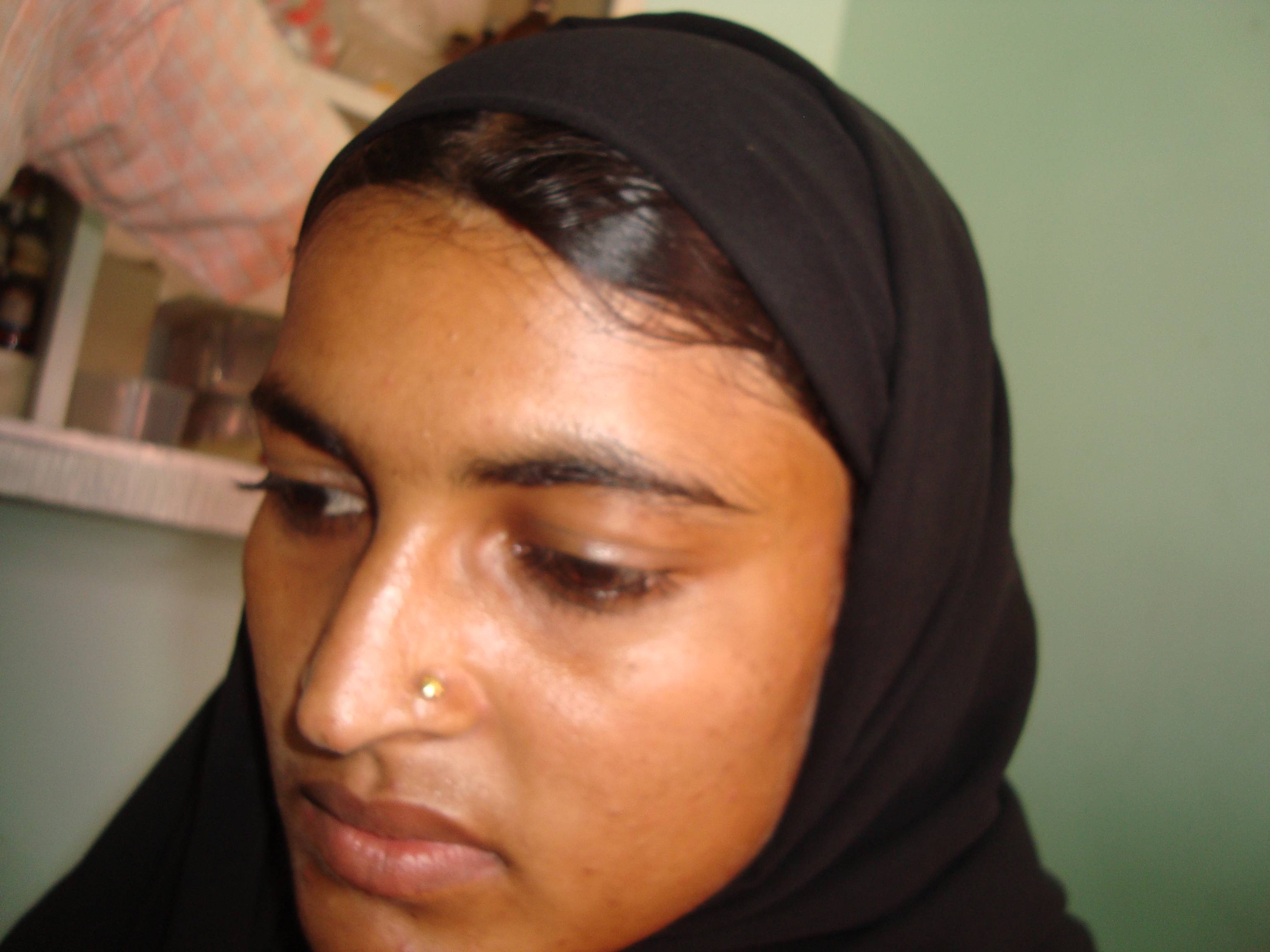 Chronic Hyper hydrosis (Sweat Problem) from last 2 - 3 years & Wart ...