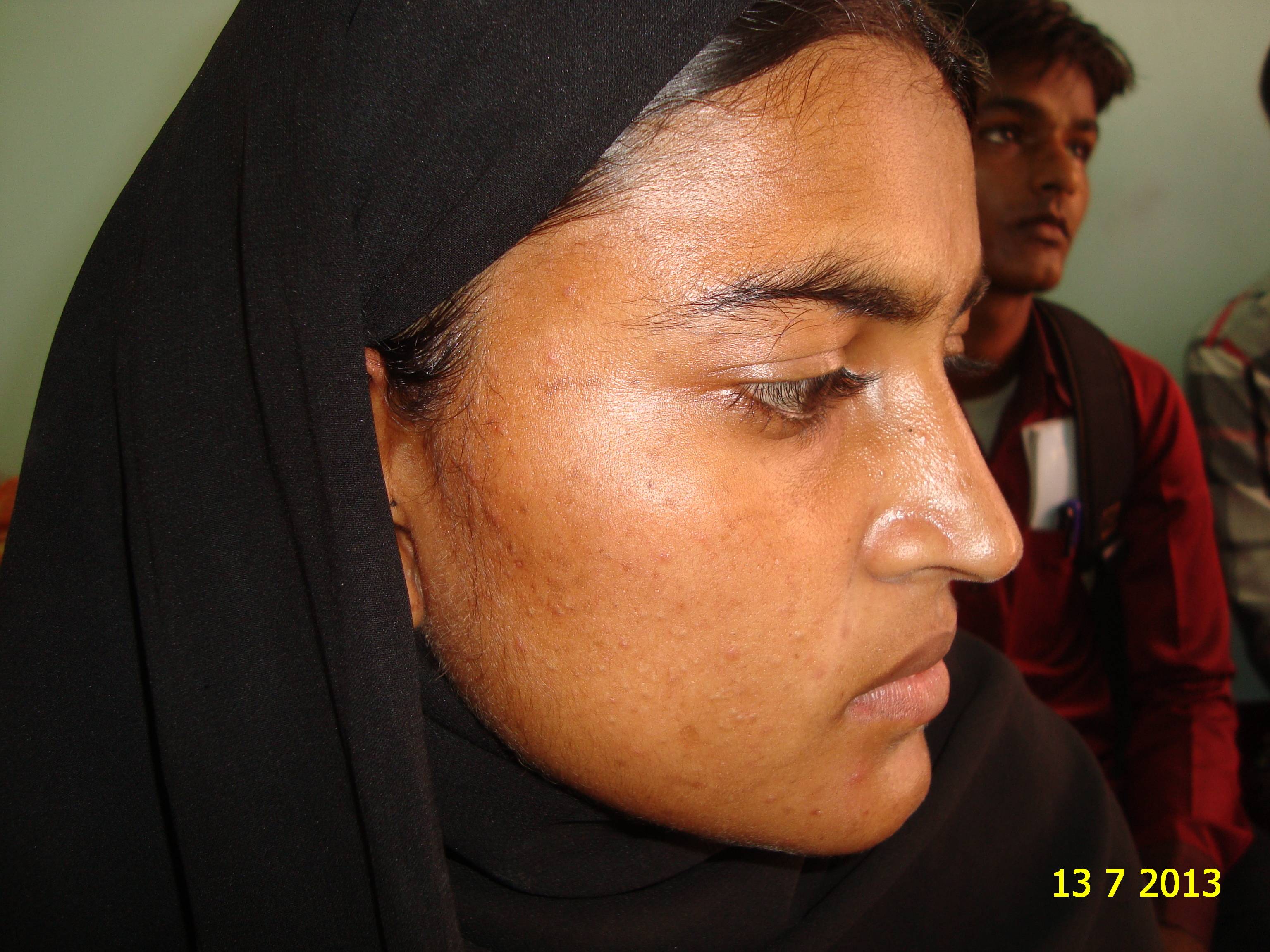 Chronic Hyper hydrosis (Sweat Problem) from last 2 - 3 years & Wart ...