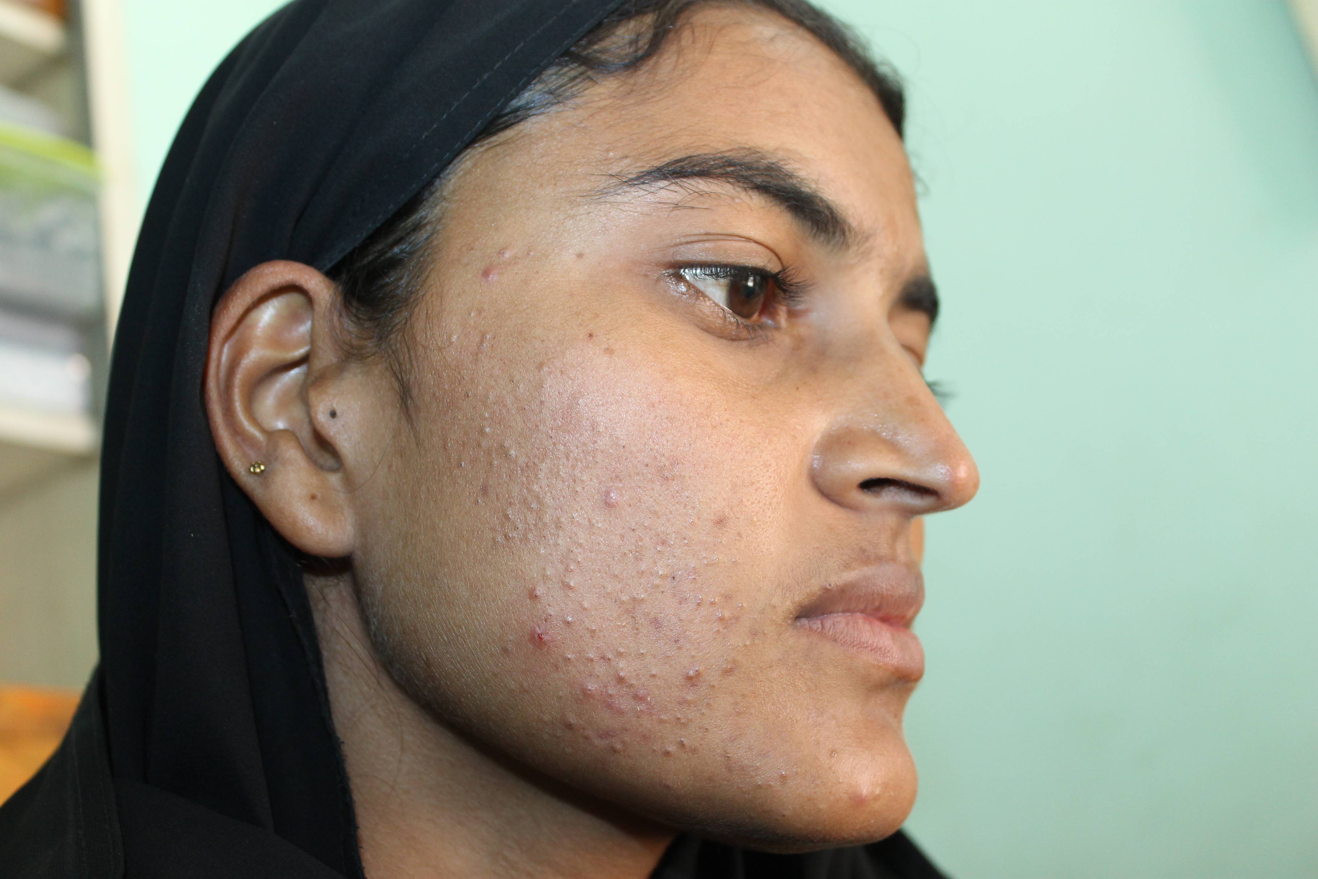 Chronic Hyper hydrosis (Sweat Problem) from last 2 - 3 years & Wart ...