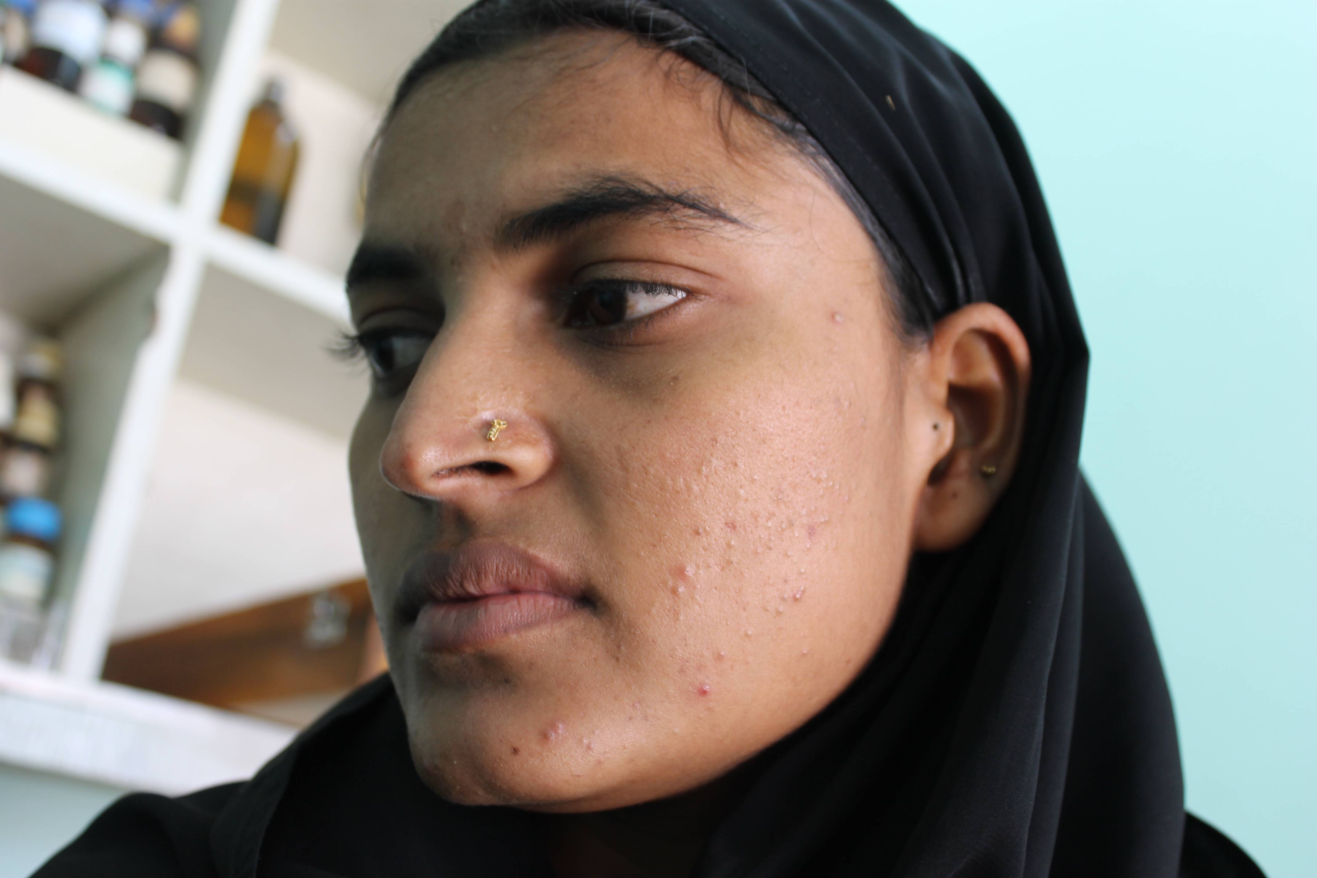 Chronic Hyper hydrosis (Sweat Problem) from last 2 - 3 years & Wart ...