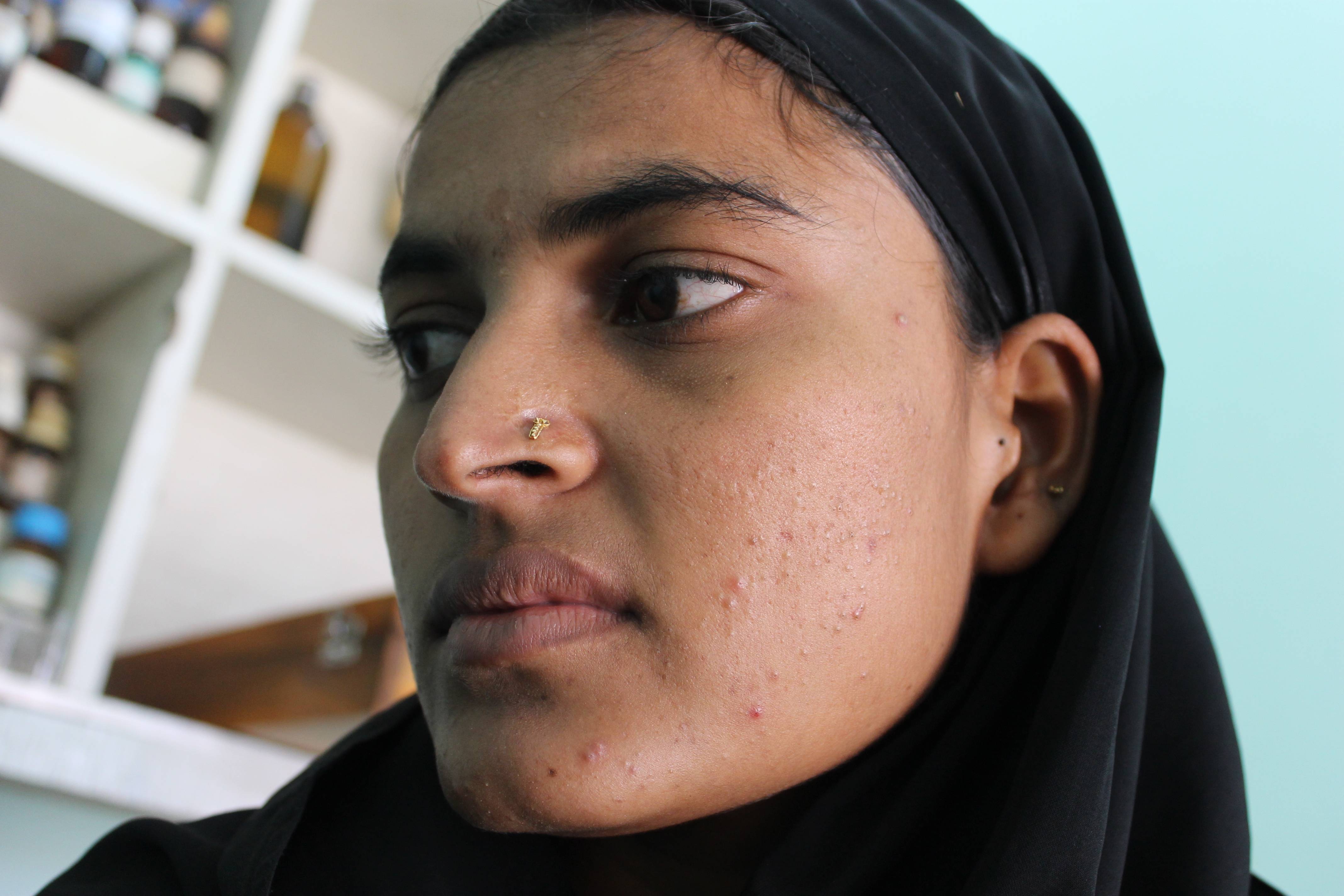 Chronic Hyper hydrosis (Sweat Problem) from last 2 - 3 years & Wart ...