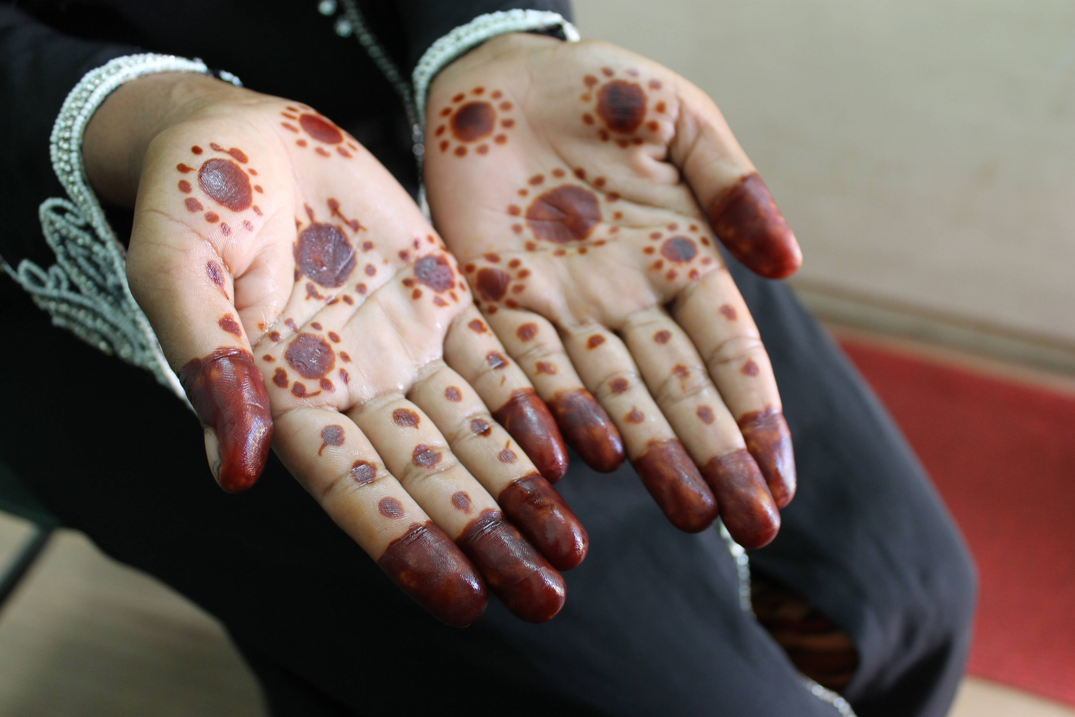 Chronic Hyper hydrosis (Sweat Problem) from last 2 - 3 years & Wart ...