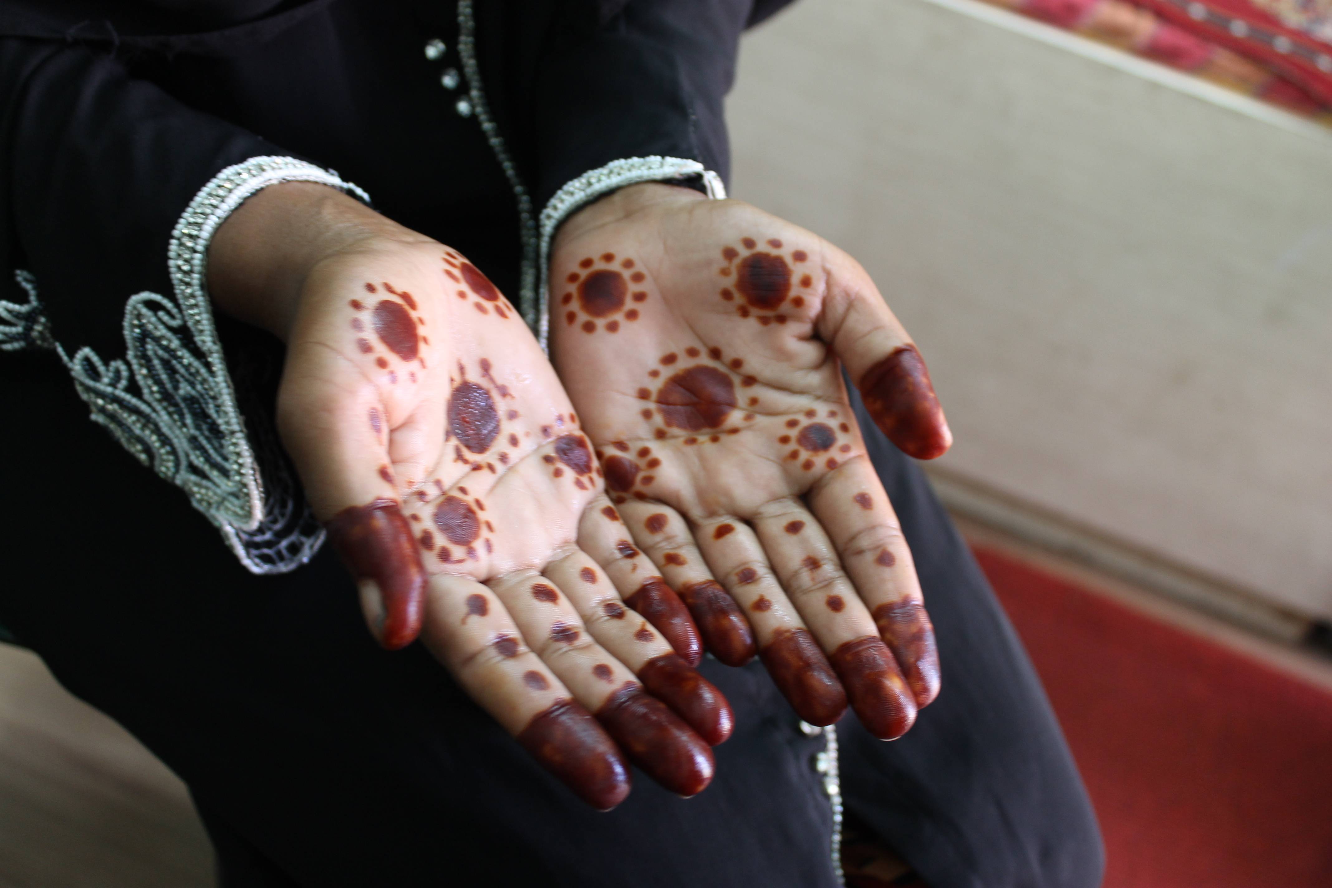 Chronic Hyper hydrosis (Sweat Problem) from last 2 - 3 years & Wart ...