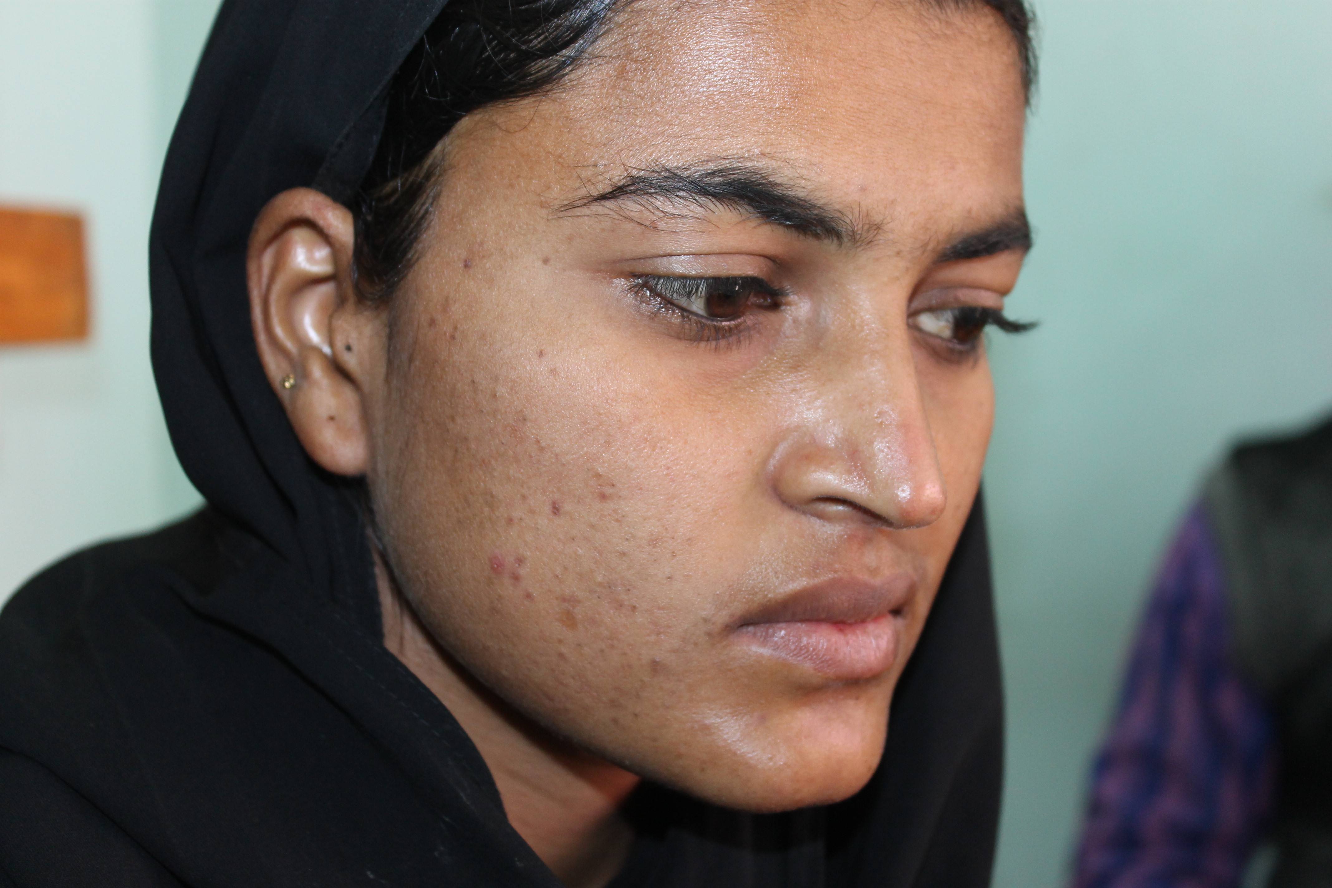 Chronic Hyper hydrosis (Sweat Problem) from last 2 - 3 years & Wart ...