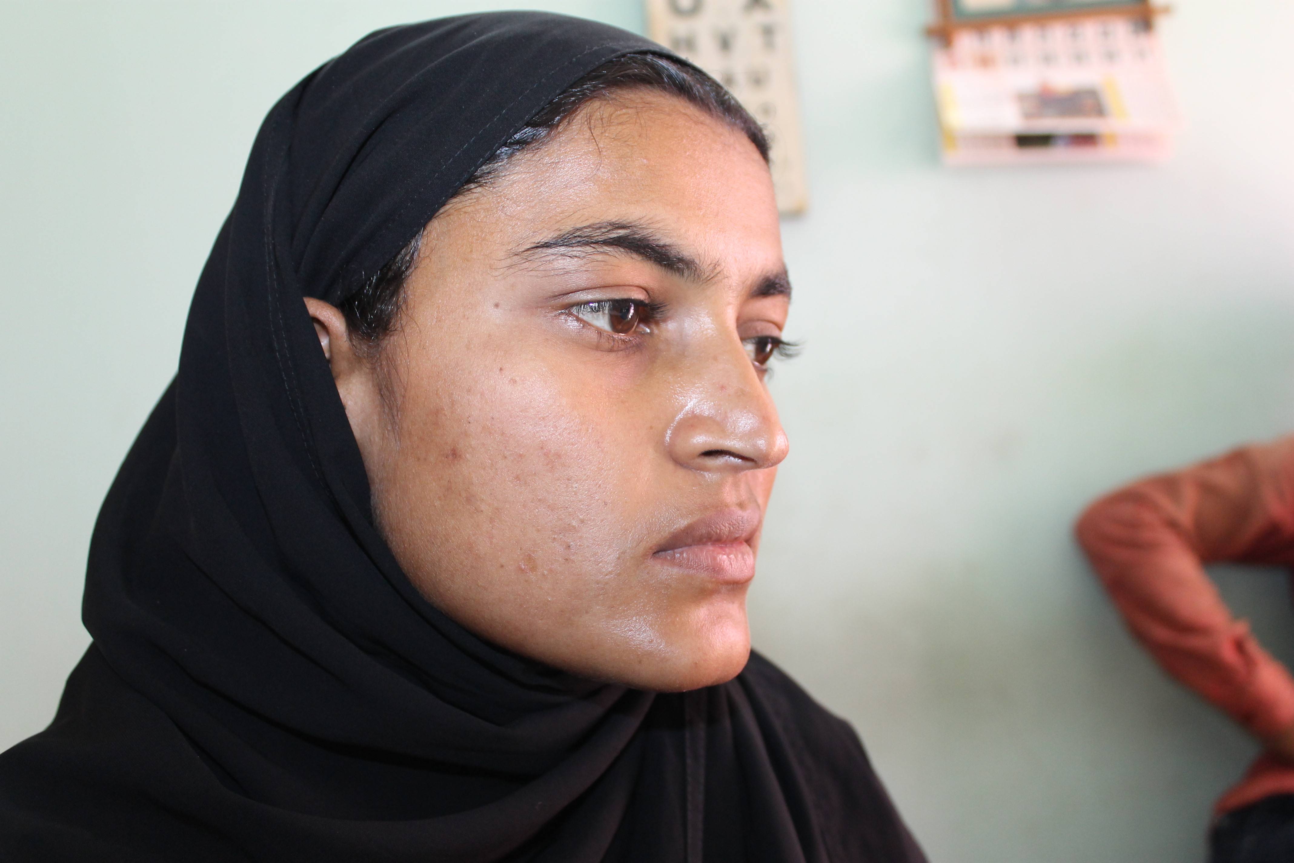 Chronic Hyper hydrosis (Sweat Problem) from last 2 - 3 years & Wart ...