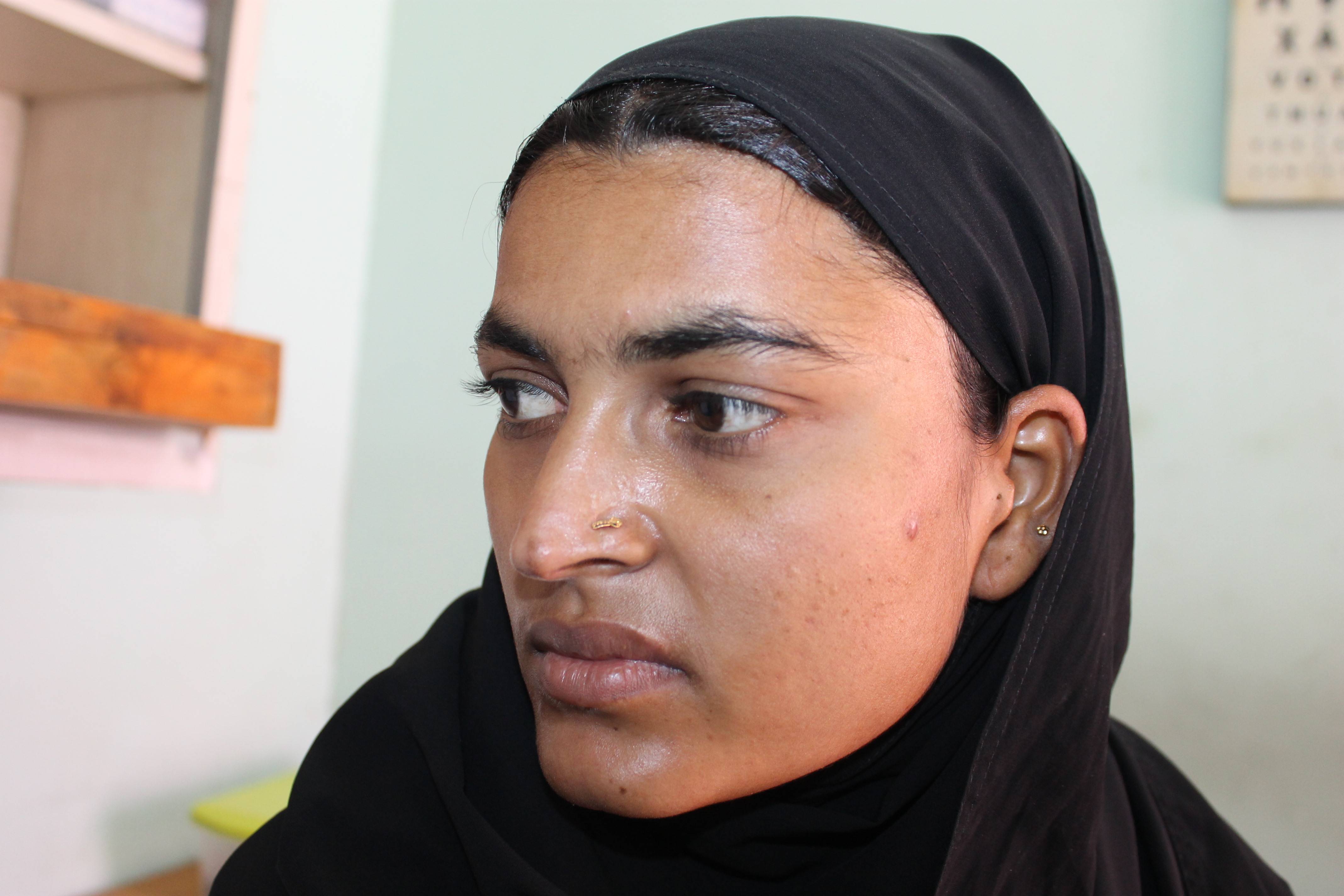 Chronic Hyper hydrosis (Sweat Problem) from last 2 - 3 years & Wart ...