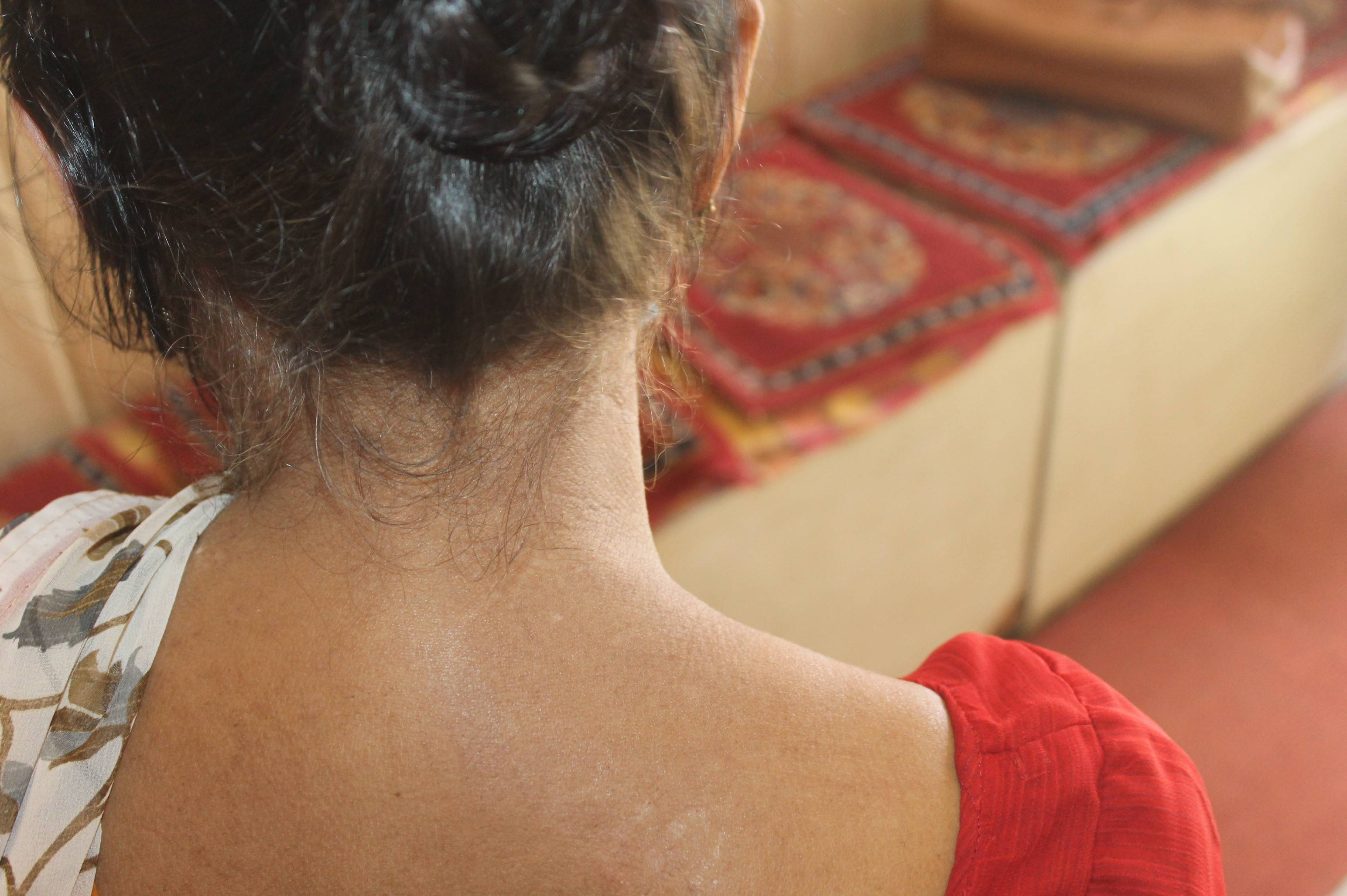 Case of Extensive Vitiligo Getting Cured with Classical homeopathy ...