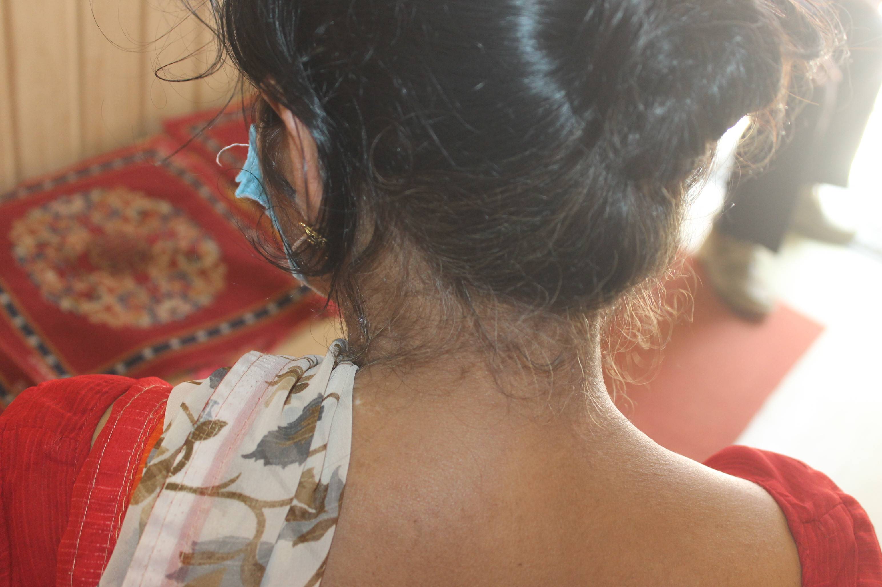 Case of Extensive Vitiligo Getting Cured with Classical homeopathy ...