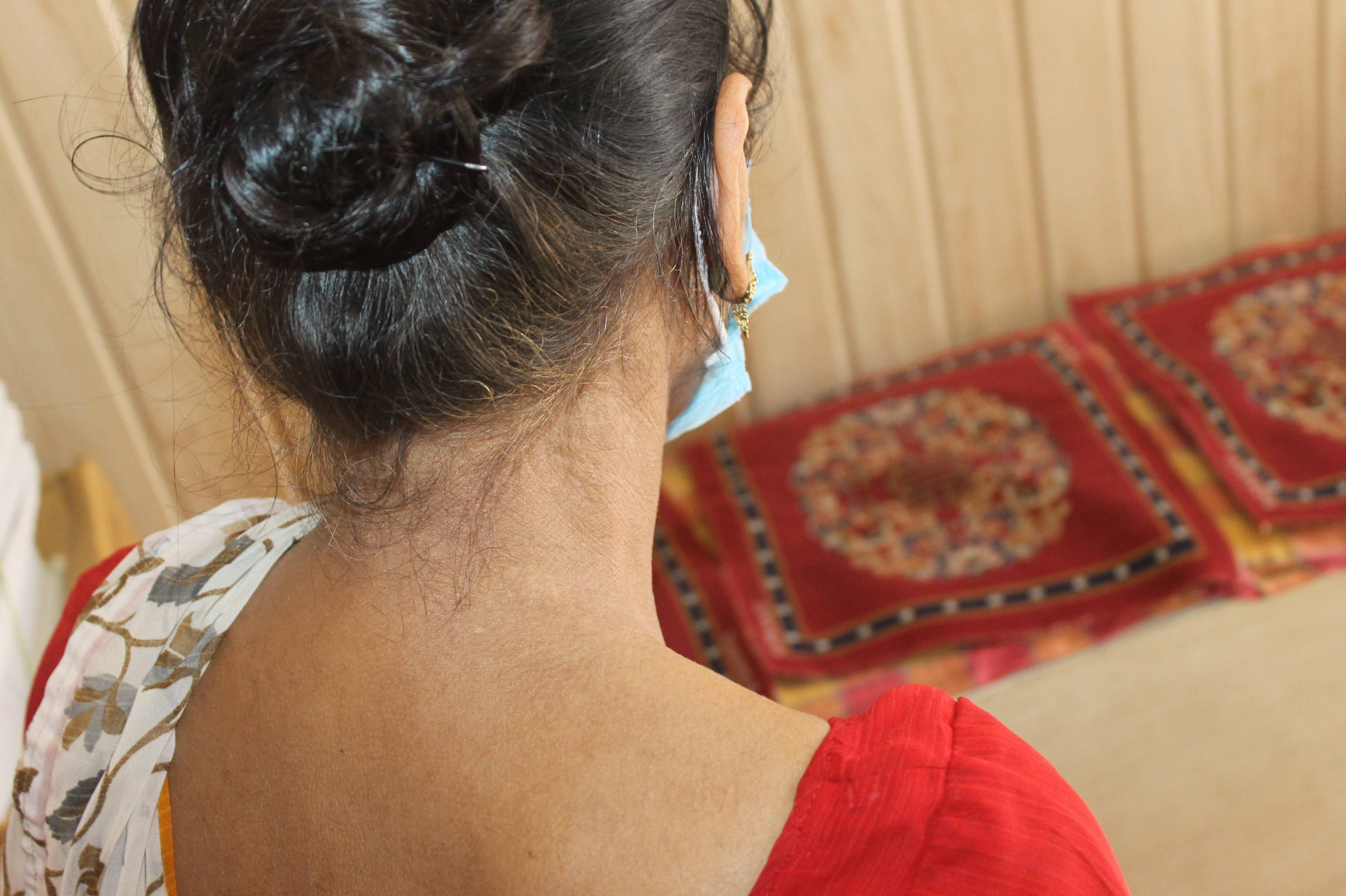 Case of Extensive Vitiligo Getting Cured with Classical homeopathy ...