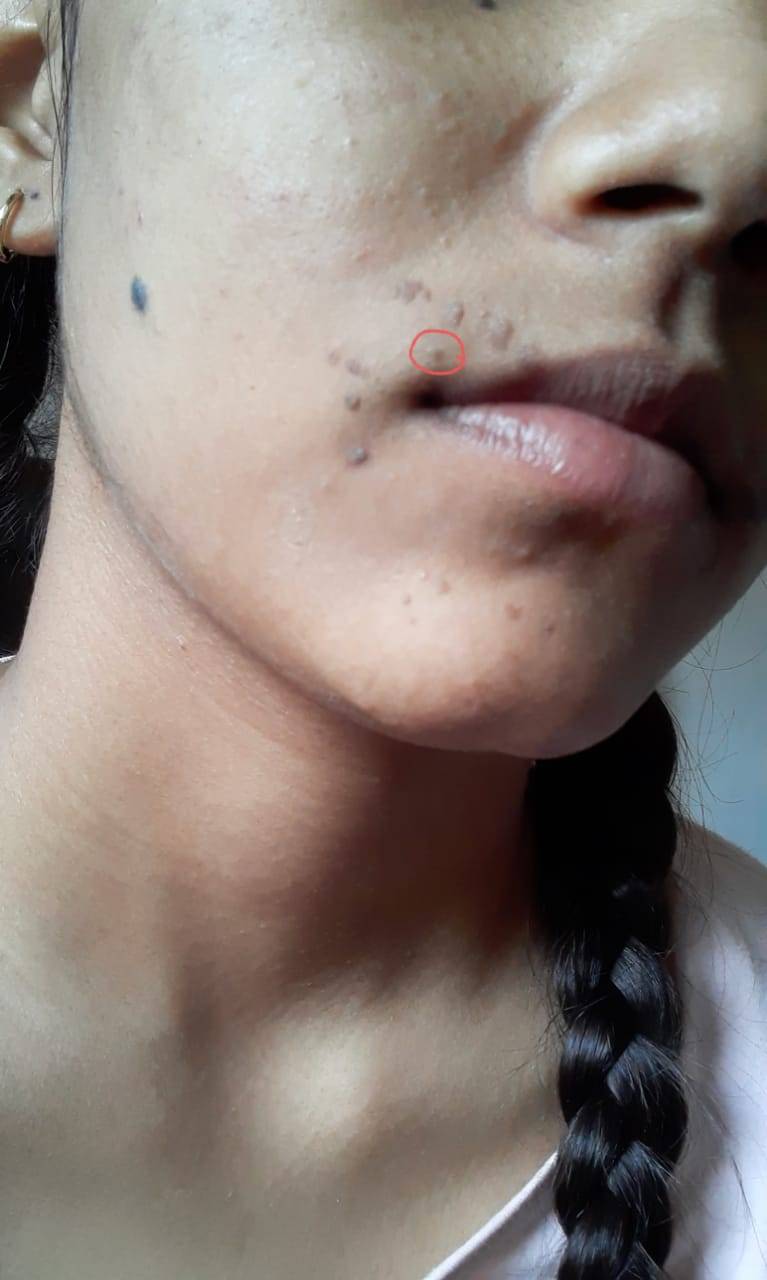 Ugly warts Cured by Classical homeopathy and medicine transmission | Case Study