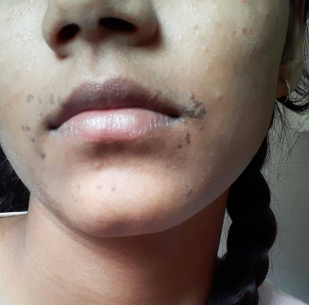 Ugly warts Cured by Classical homeopathy and medicine transmission | Case Study